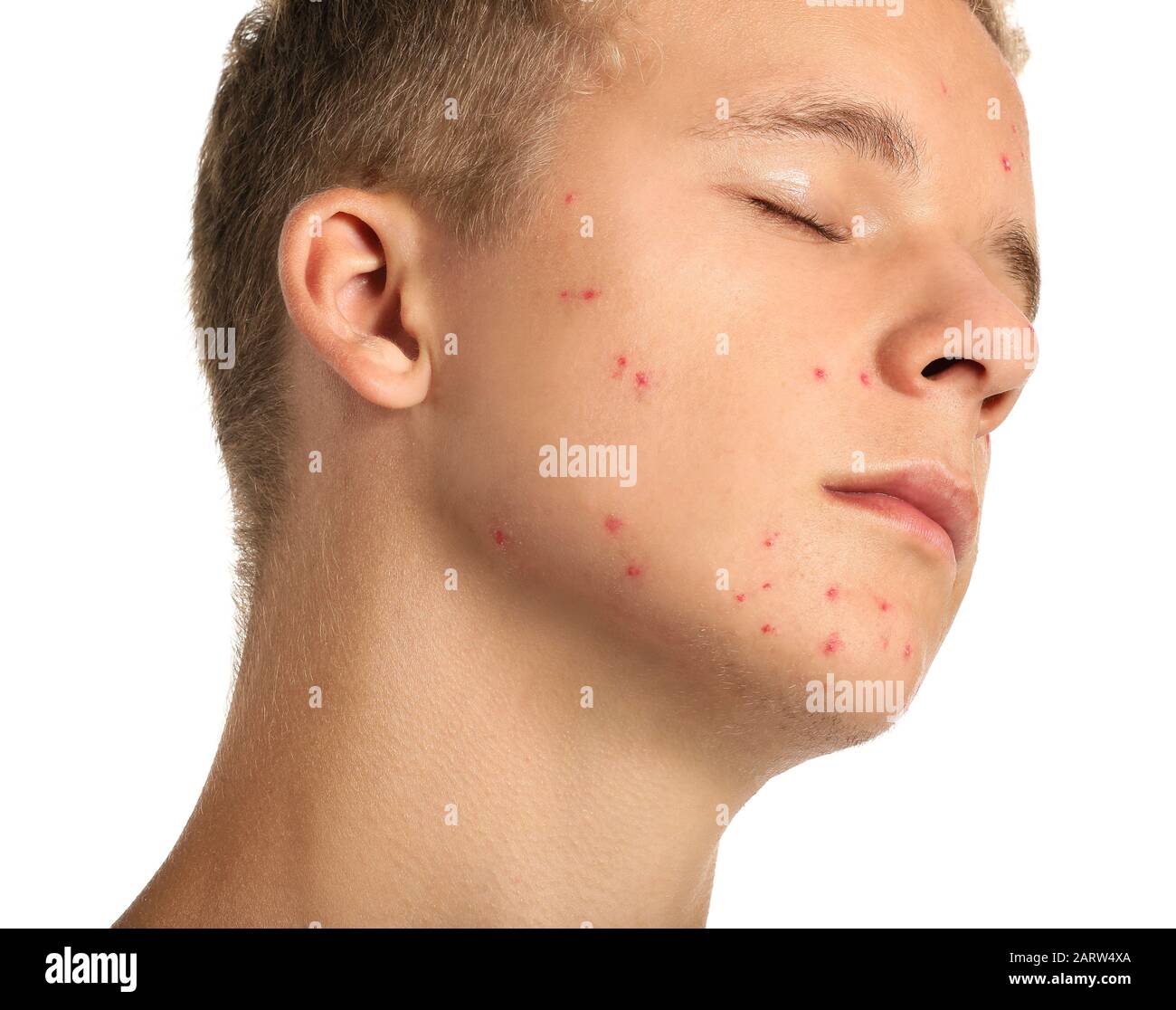 Teenage boy with acne problem on white background Stock Photo - Alamy
