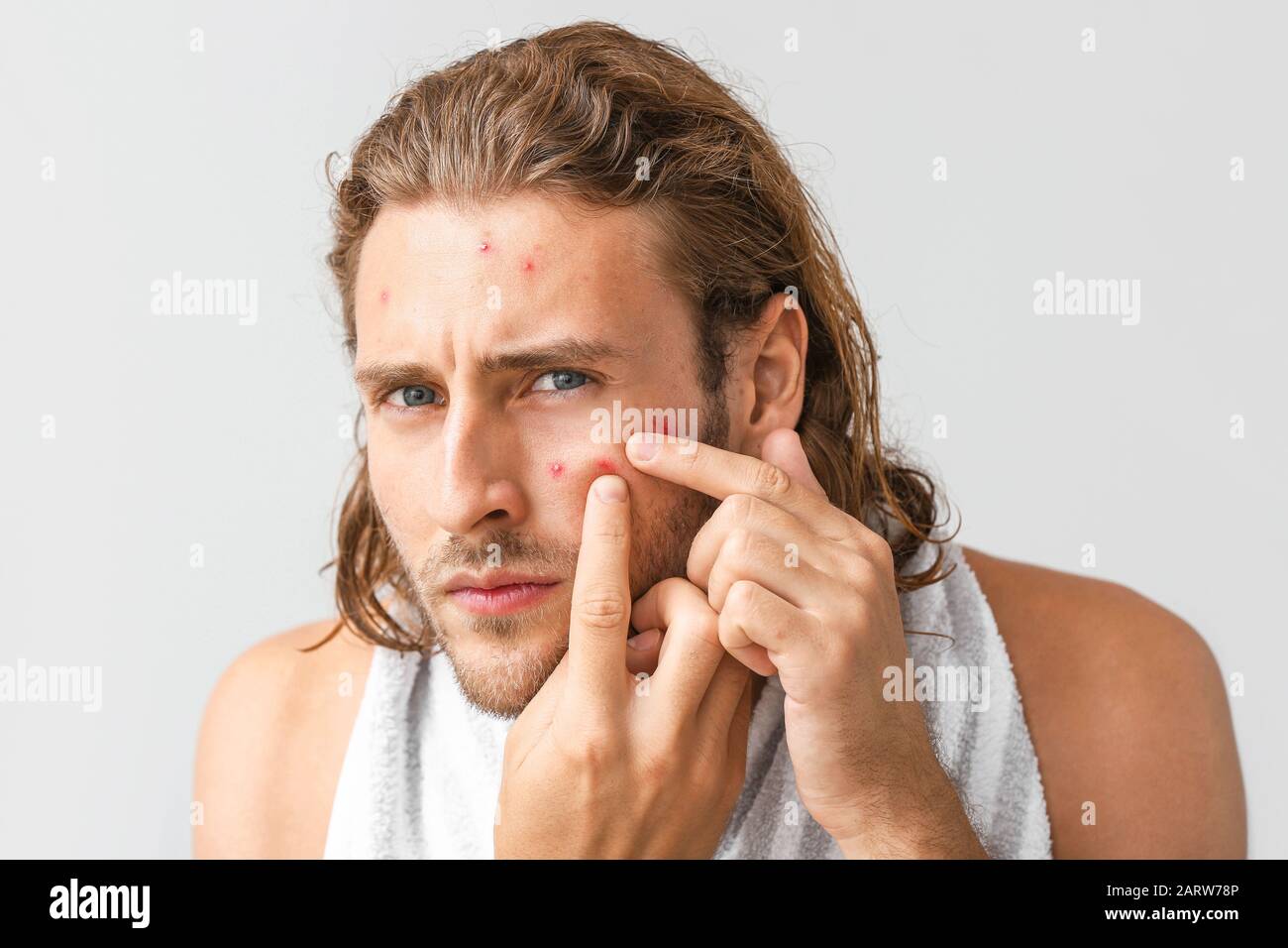 Portrait of young man with acne problem squishing pimples on light ...