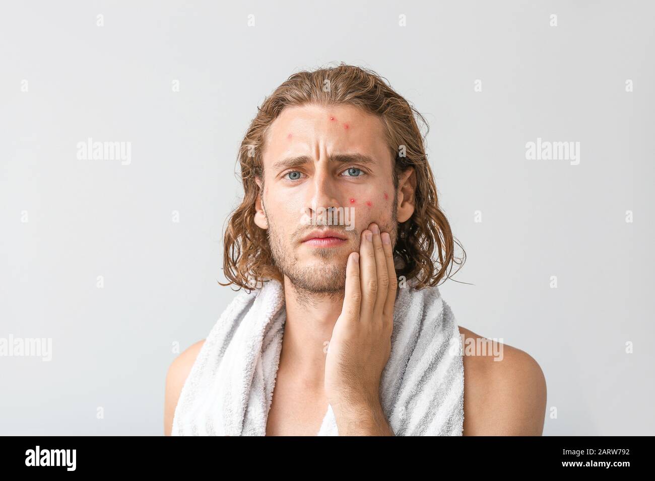 Portrait of young man with acne problem on light background Stock Photo ...