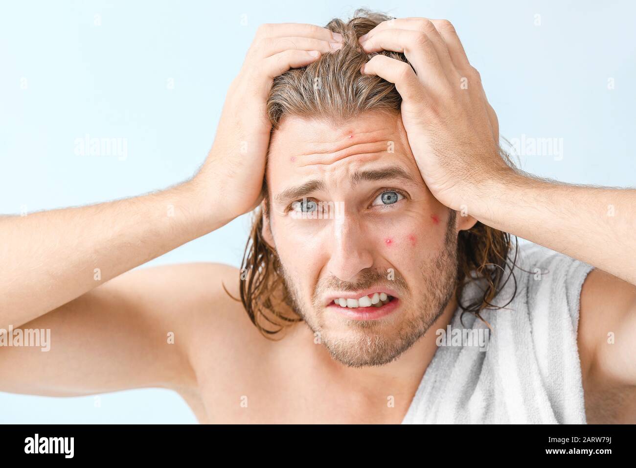Portrait of young man with acne problem on color background Stock Photo ...