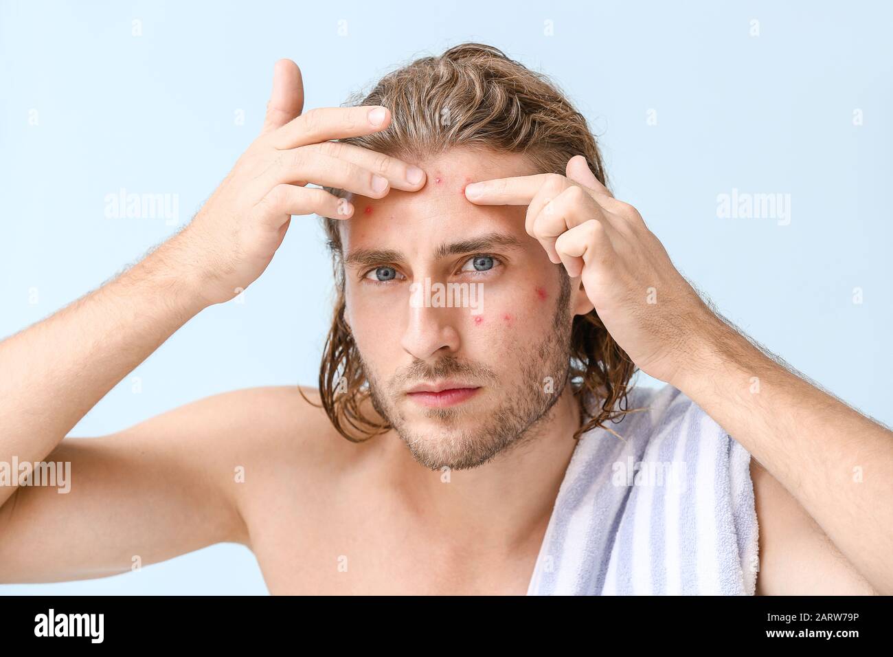 Portrait of young man with acne problem squishing pimples on color ...