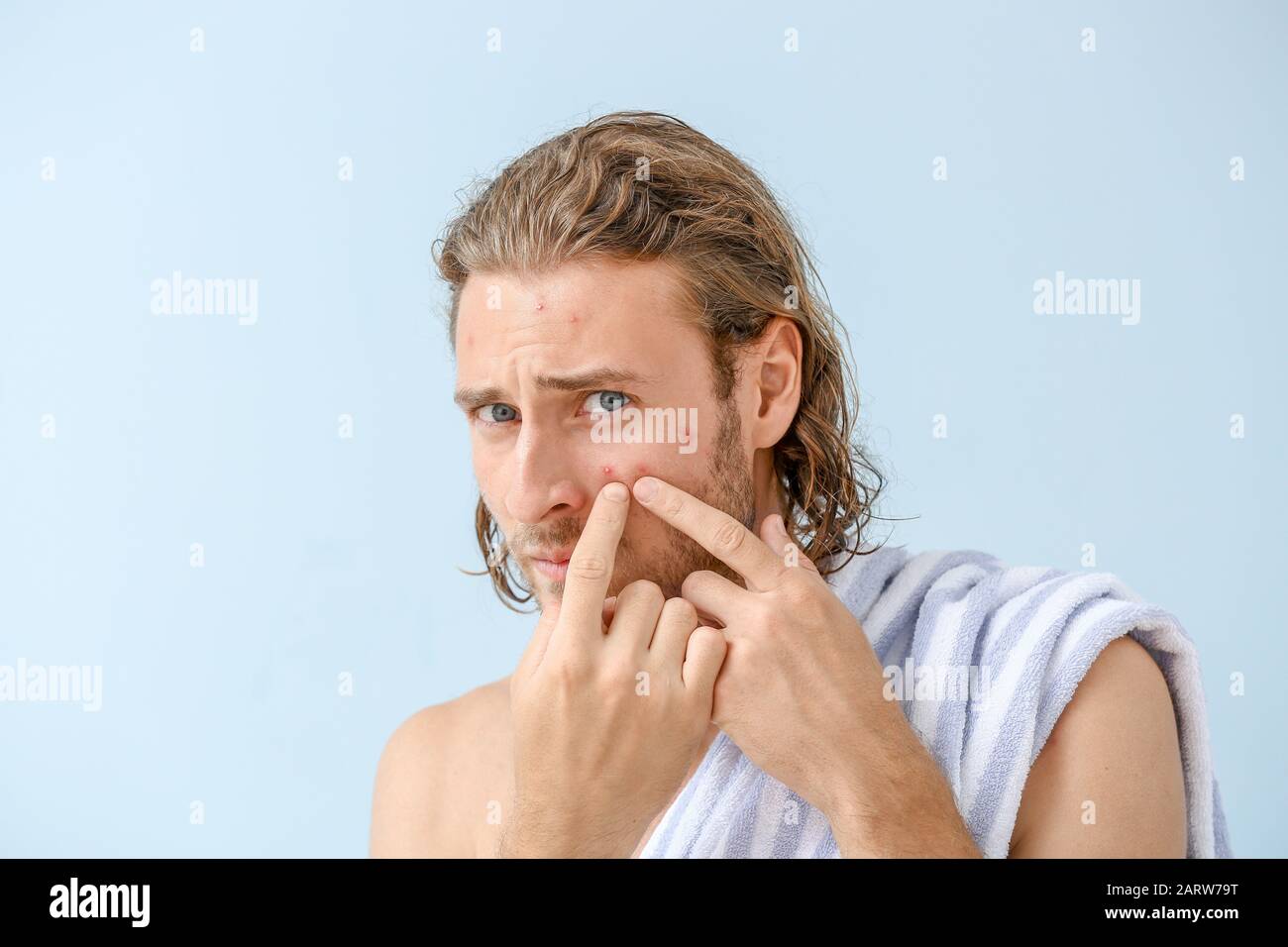 Portrait of young man with acne problem squishing pimples on color ...