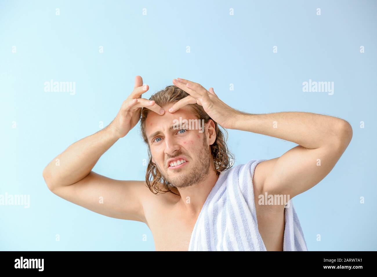 Portrait of young man with acne problem squishing pimples on color ...