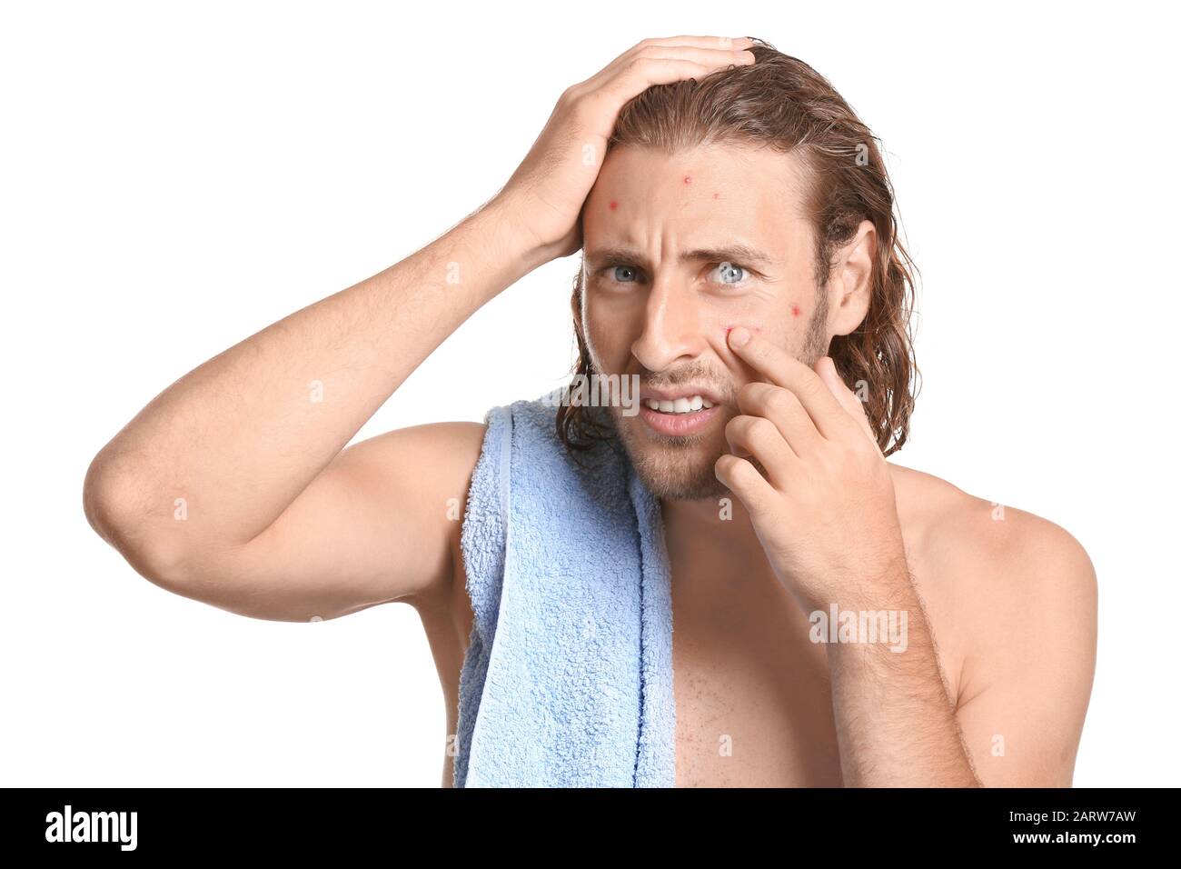 Portrait of young man with acne problem on white background Stock Photo ...