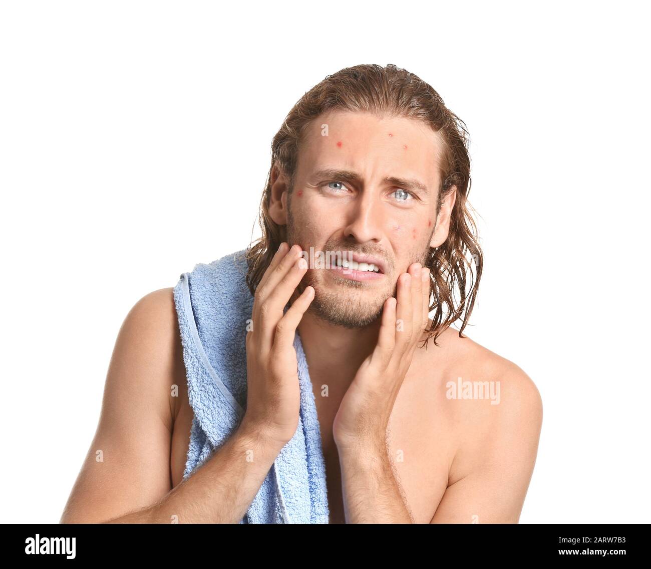 Portrait of young man with acne problem on white background Stock Photo ...