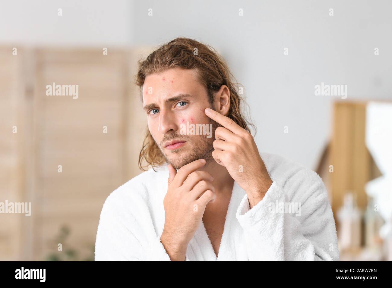 Portrait of young man with acne problem at home Stock Photo - Alamy