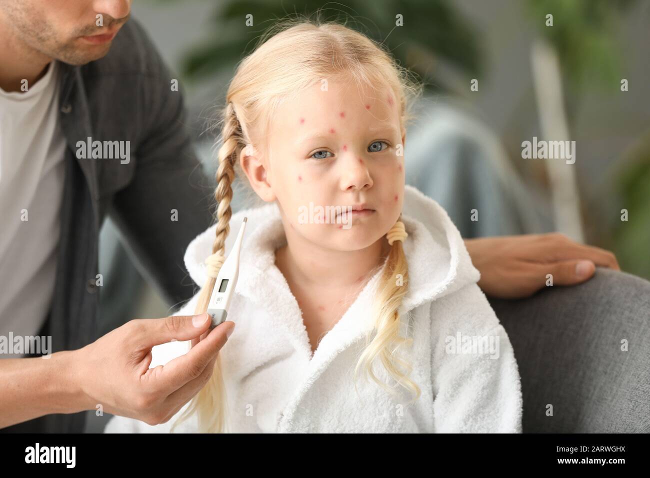 Chicken pox adult hi-res stock photography and images - Alamy