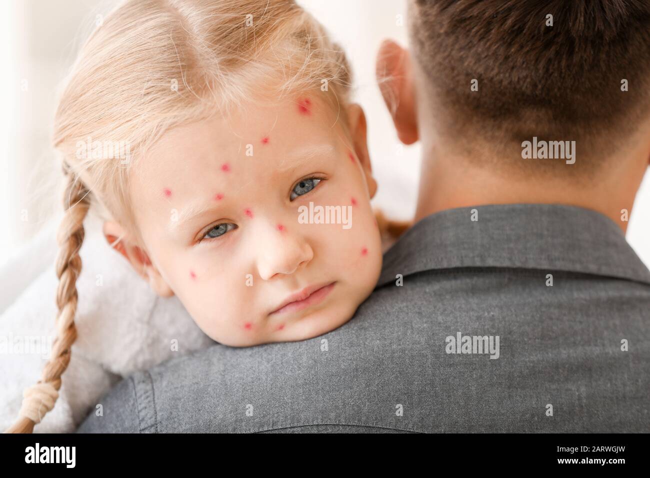 Man taking care of his little daughter ill with chickenpox at home ...