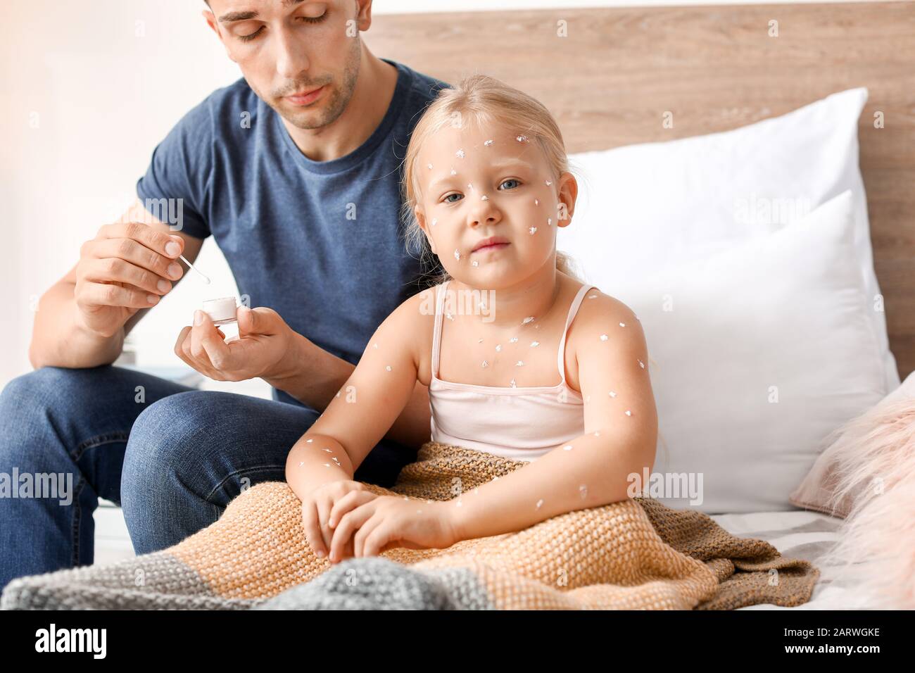 Chicken Pox Adult High Resolution Stock Photography and Images - Alamy