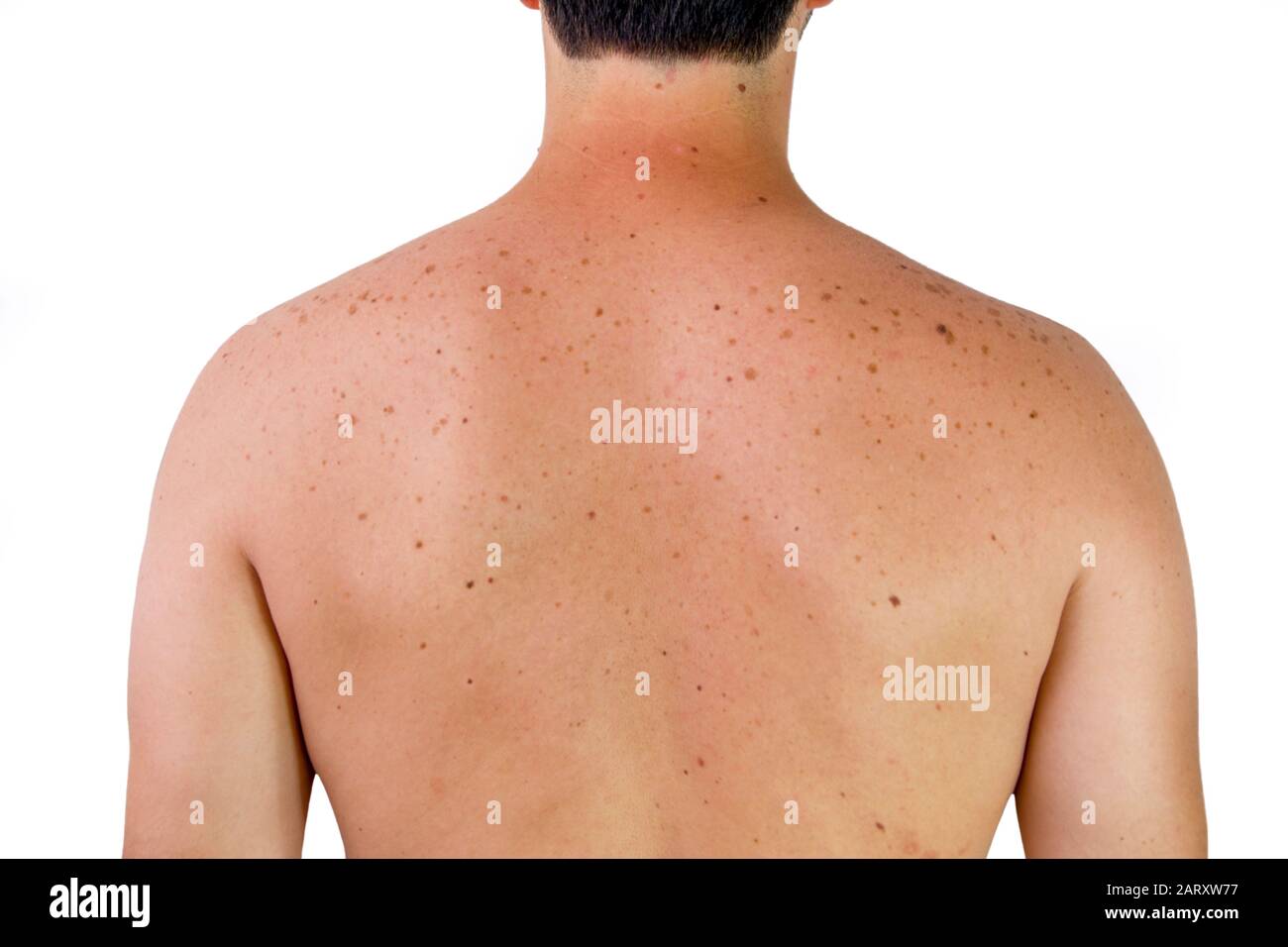 Non melanoma skin cancer hi-res stock photography and images - Alamy