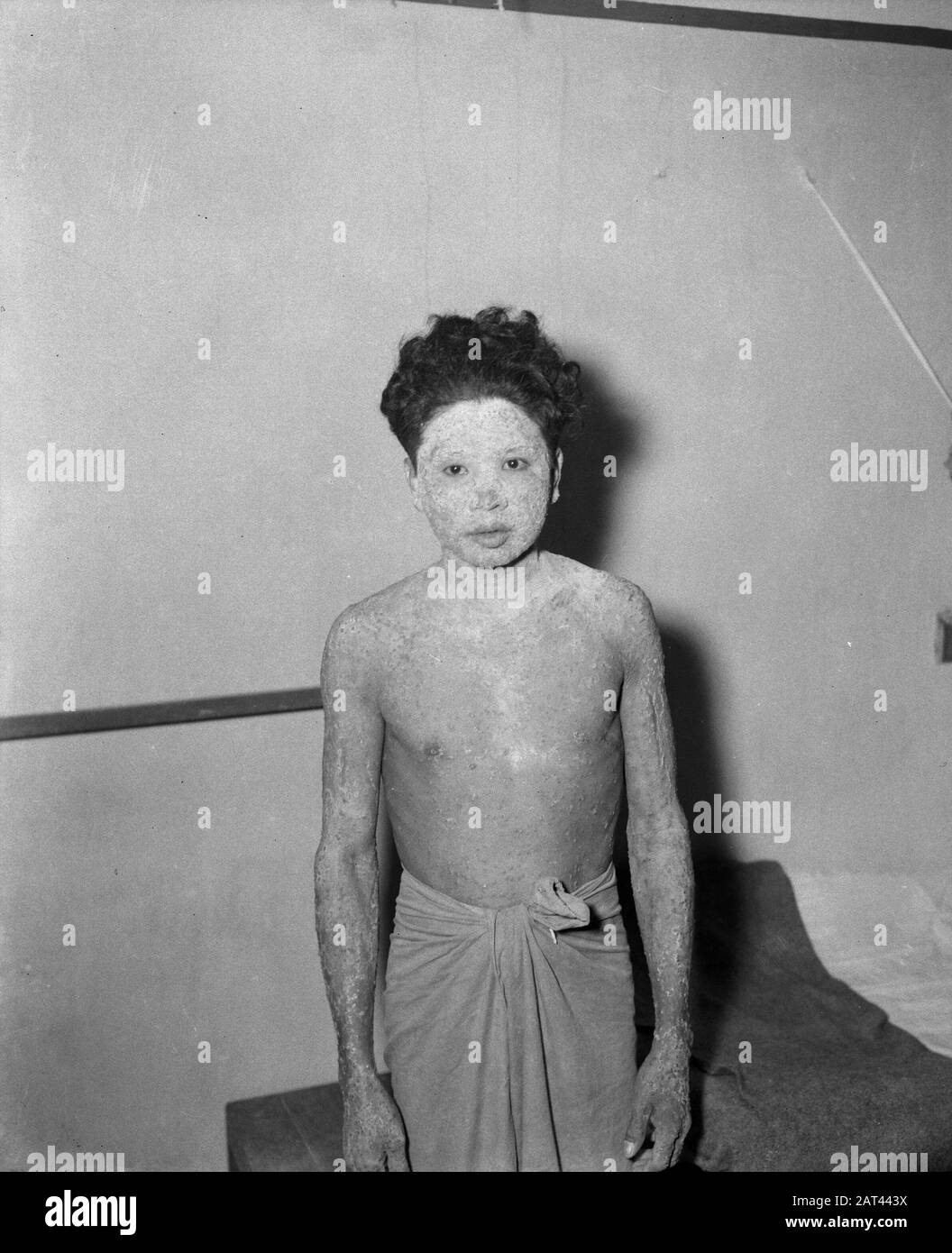 Indonesian man (with severe skin disease?) Date: January 1948 Location ...