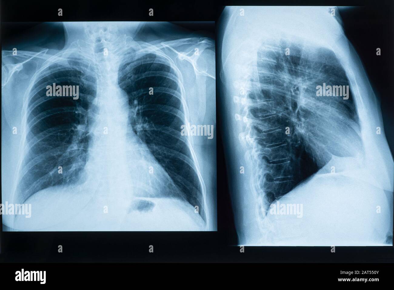 Healthy woman lungs x-ray image or radiography. Medical and healthcare ...