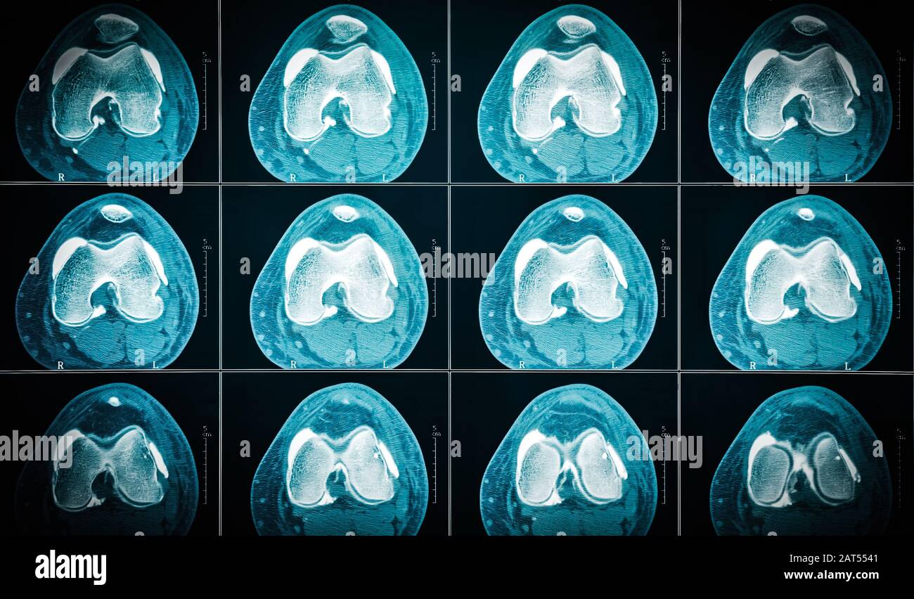 Knee joint ct scan hi-res stock photography and images - Alamy