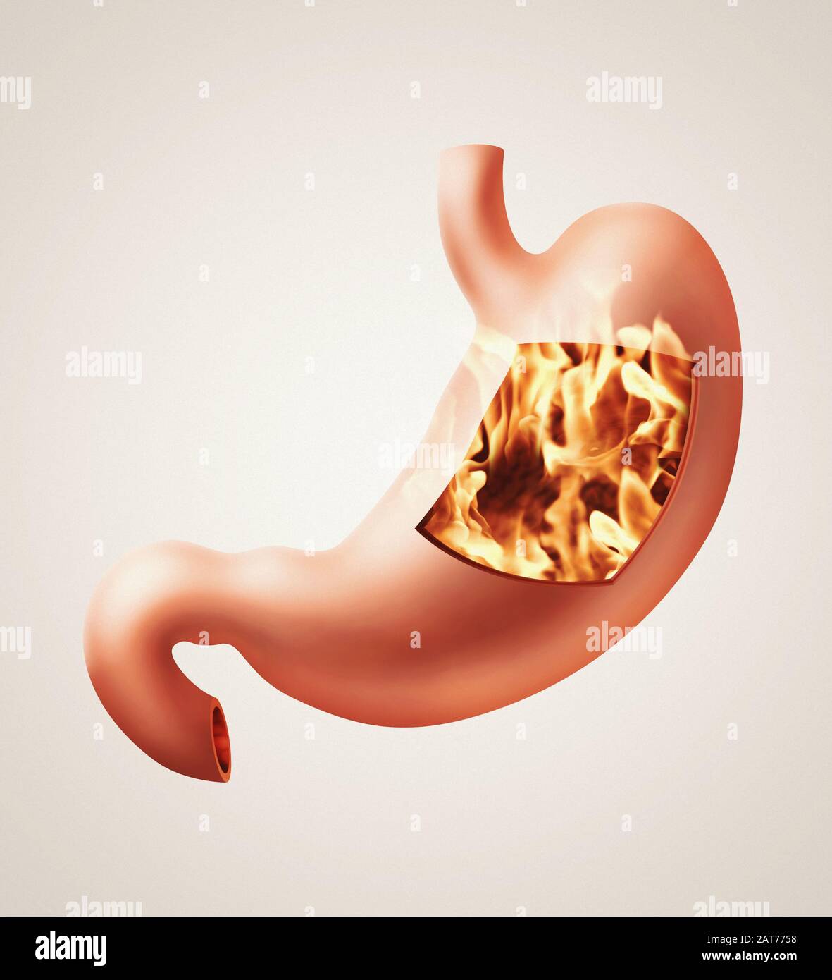 Photorealistic illustration of human stomach with heartburn disease ...