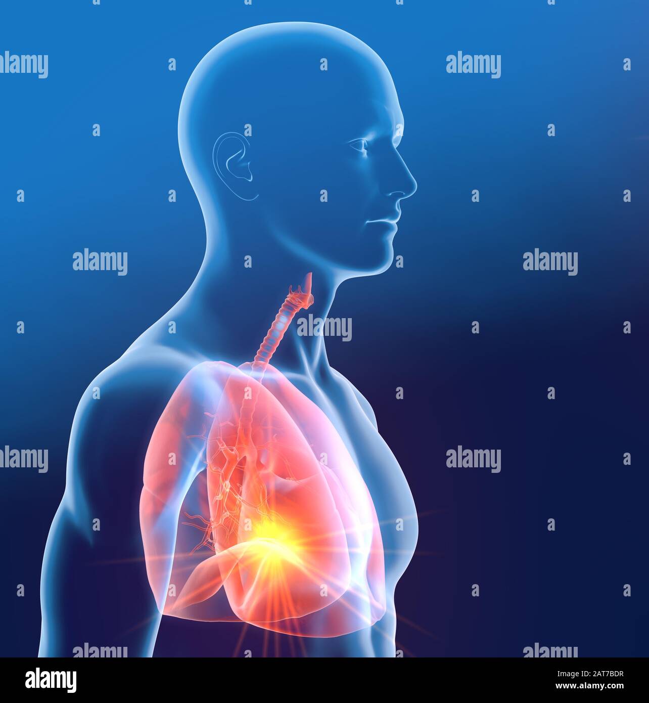 3D illustration showing male lungs with inflammtion, pneumonia Stock ...