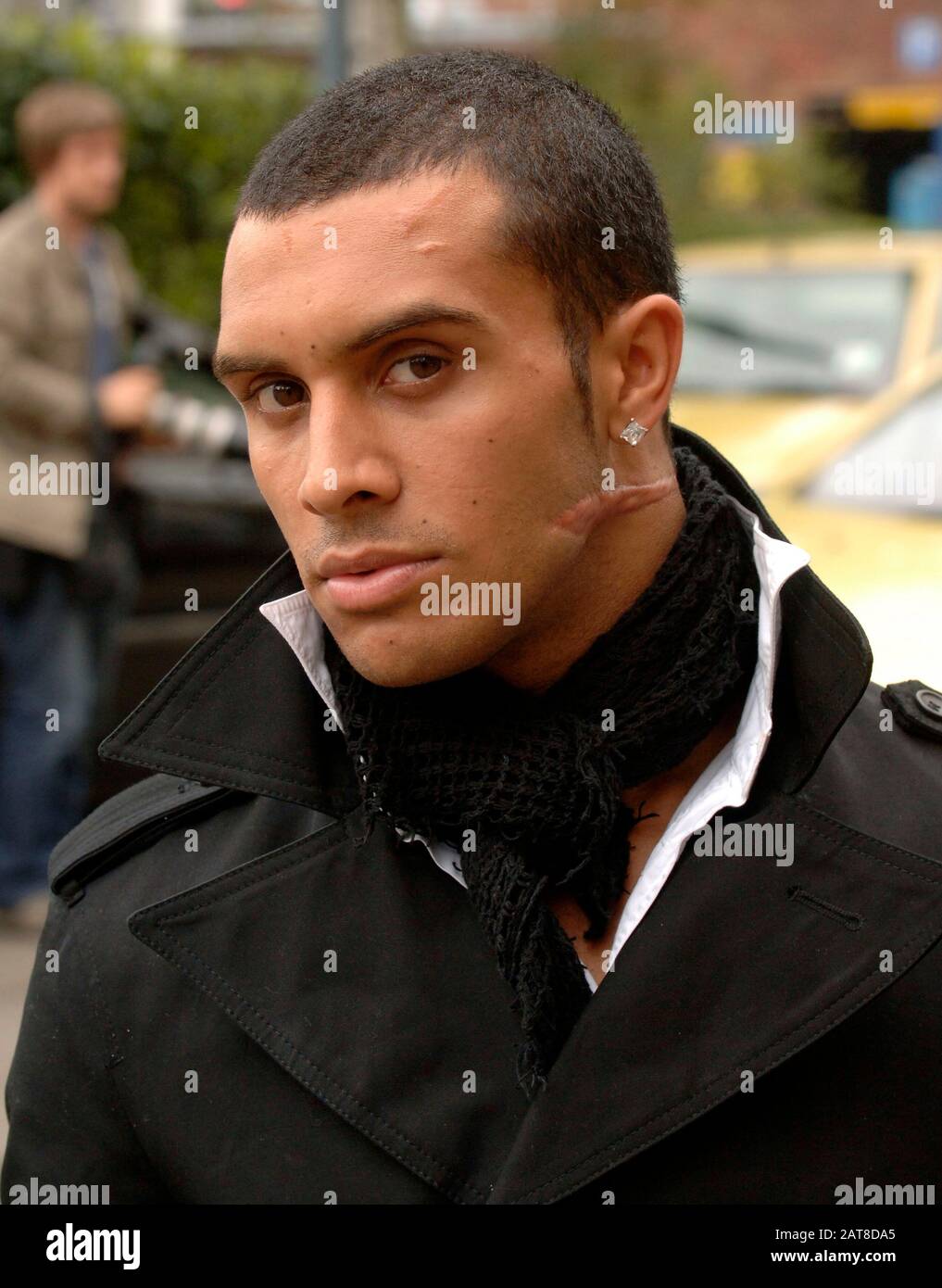 English rock singer Jerome Simeon displaying the scar on his neck ...