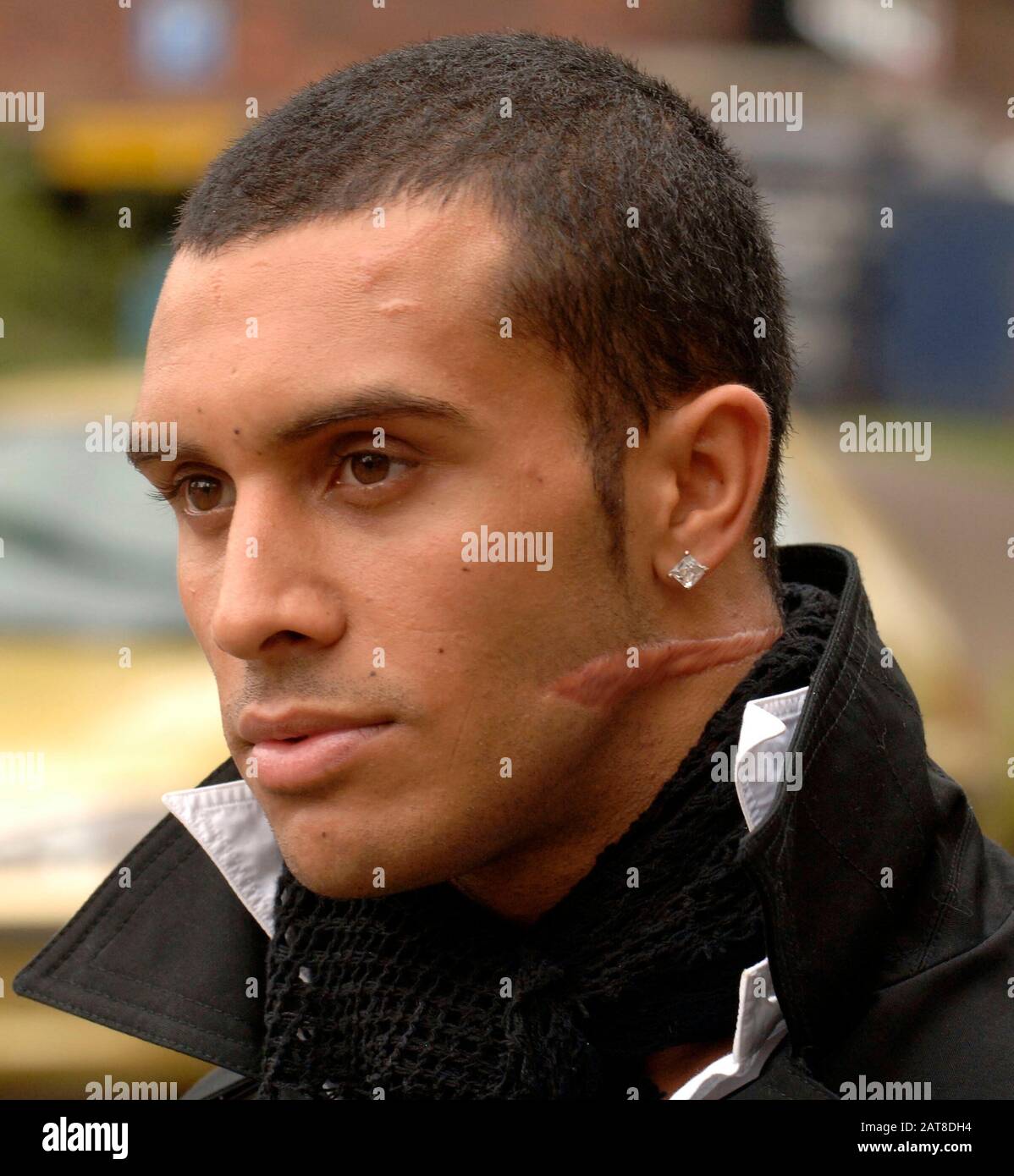 English rock singer Jerome Simeon displaying the scar on his neck ...