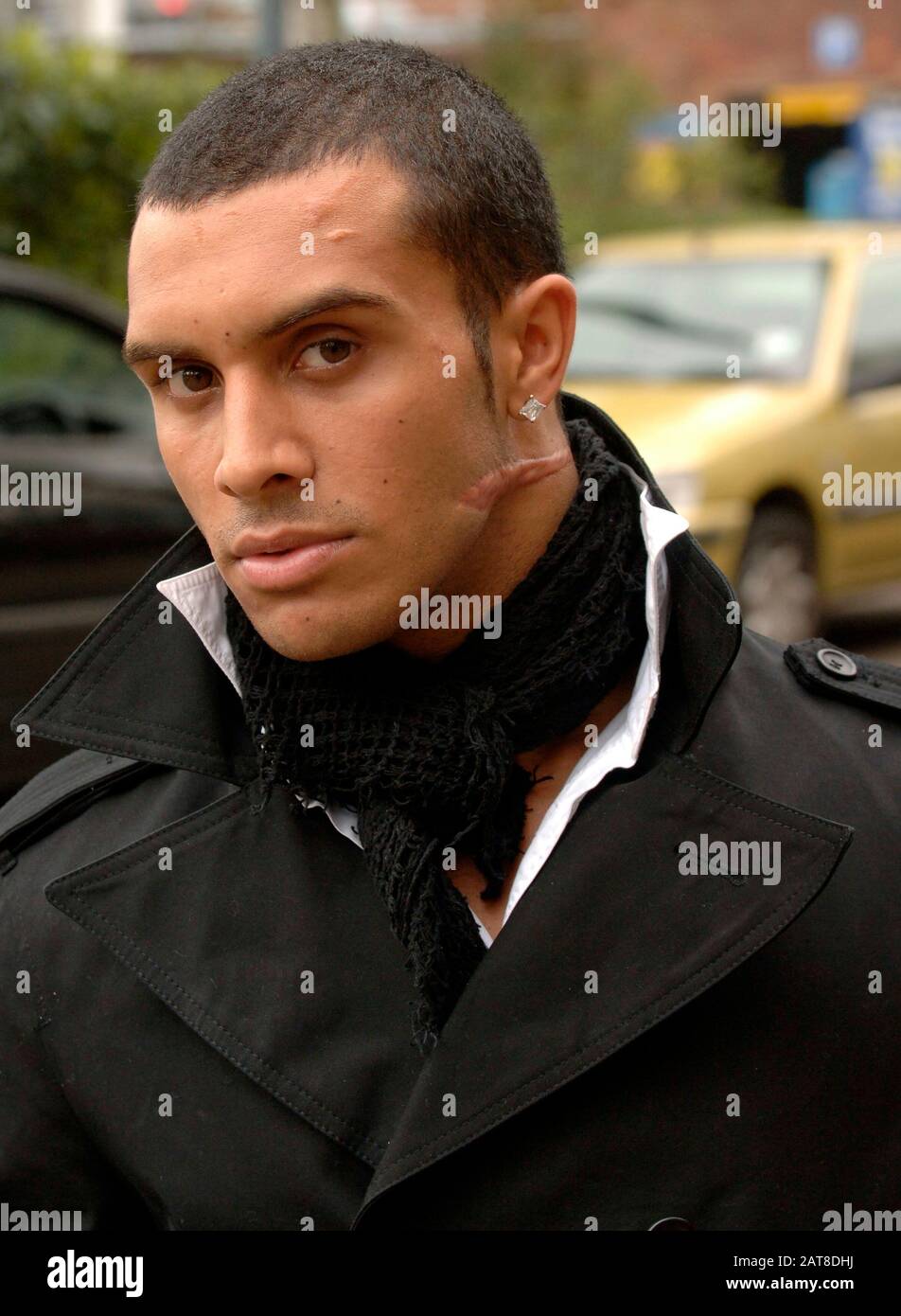 English rock singer Jerome Simeon displaying the scar on his neck ...