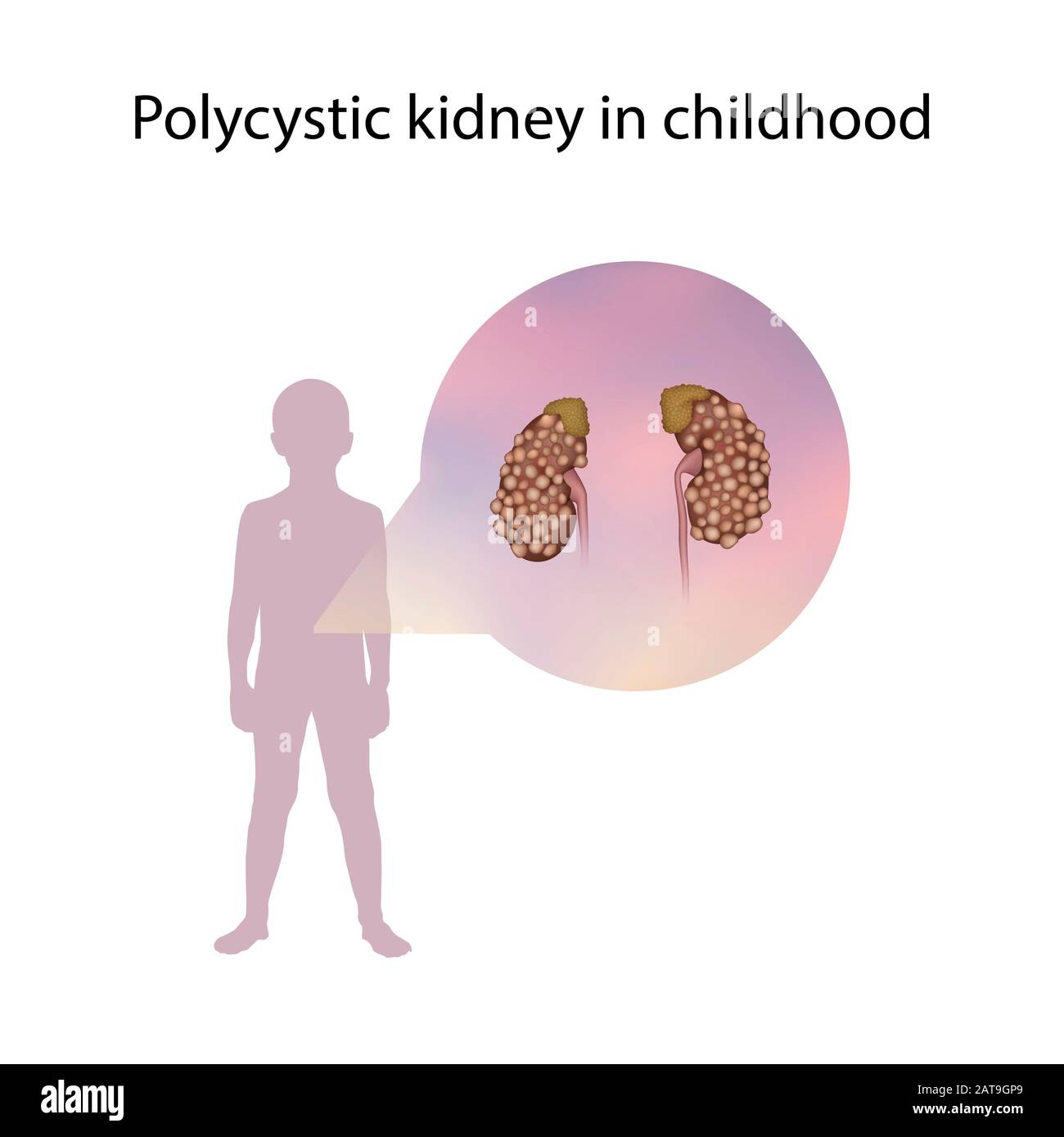 Polycystic kidney disease hi-res stock photography and images - Alamy