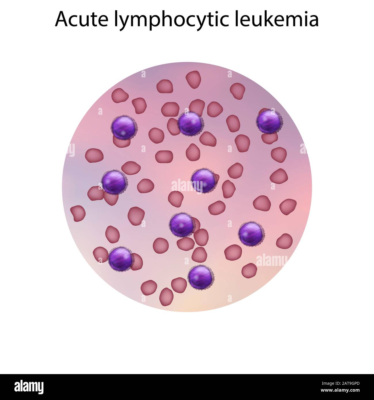 Acute lymphocytic leukaemia, illustration Stock Photo - Alamy
