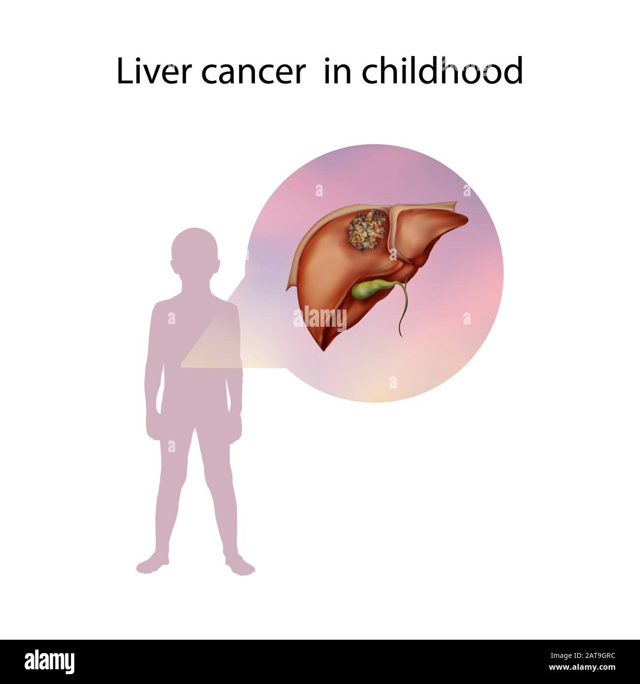 Childhood oncology hi-res stock photography and images - Alamy