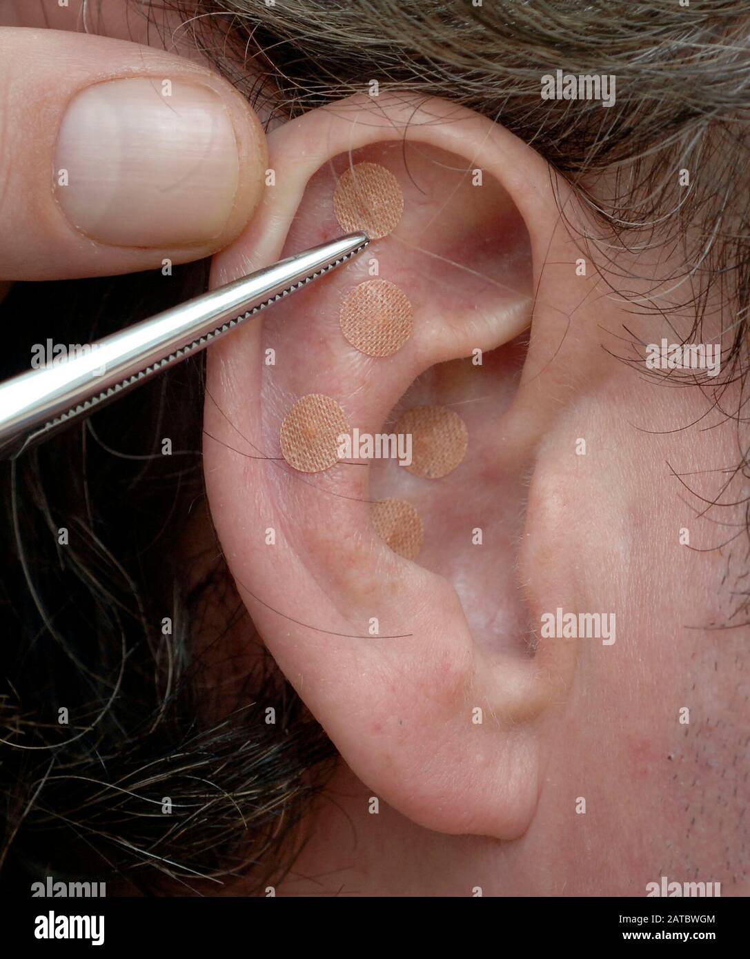 TV chef Ross Burden undergoing an acupuncture procedure at the Hale ...