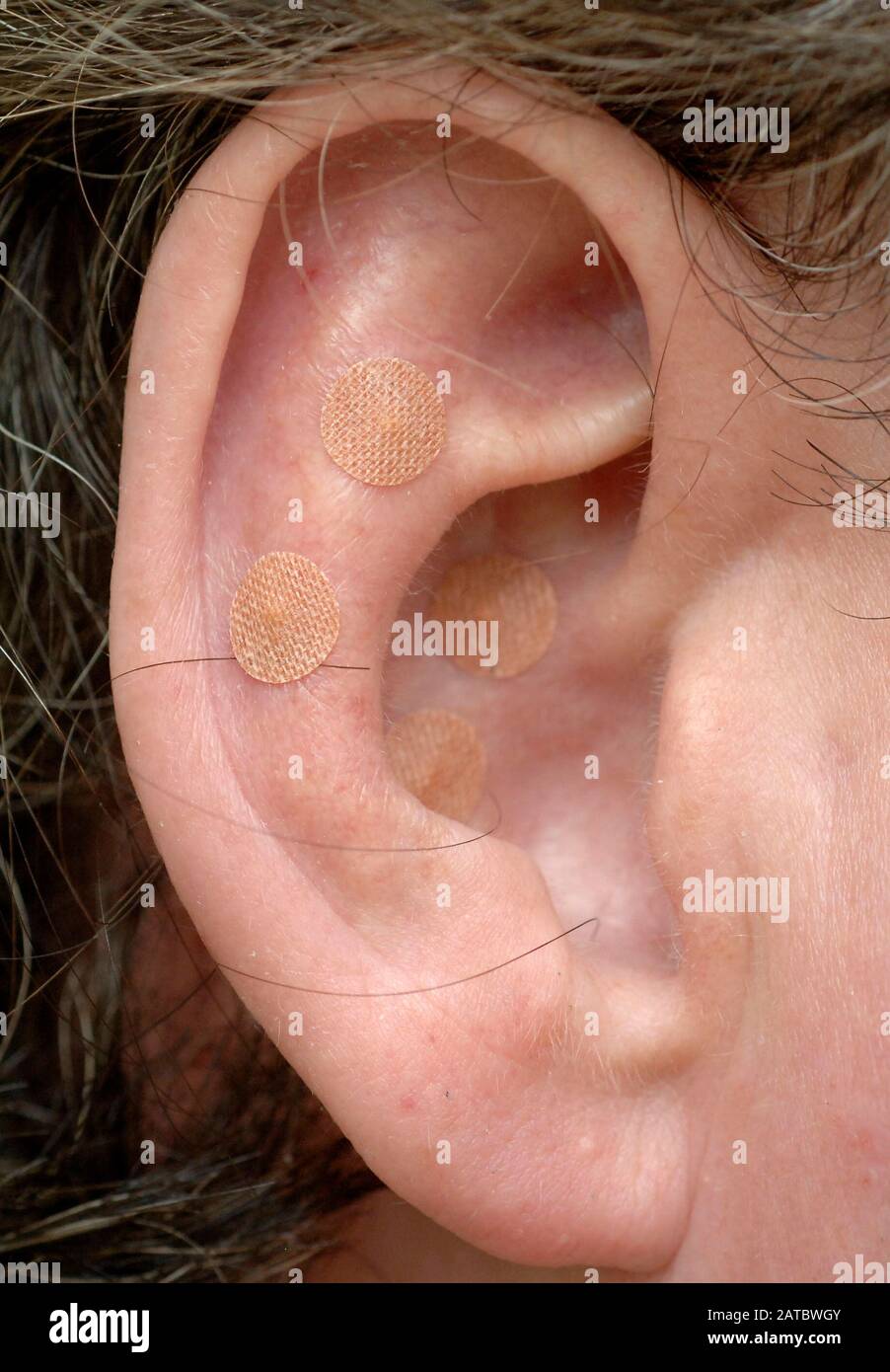 TV chef Ross Burden undergoing an acupuncture procedure at the Hale ...