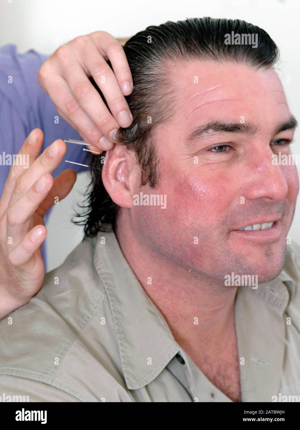 TV chef Ross Burden undergoing an acupuncture procedure at the Hale ...