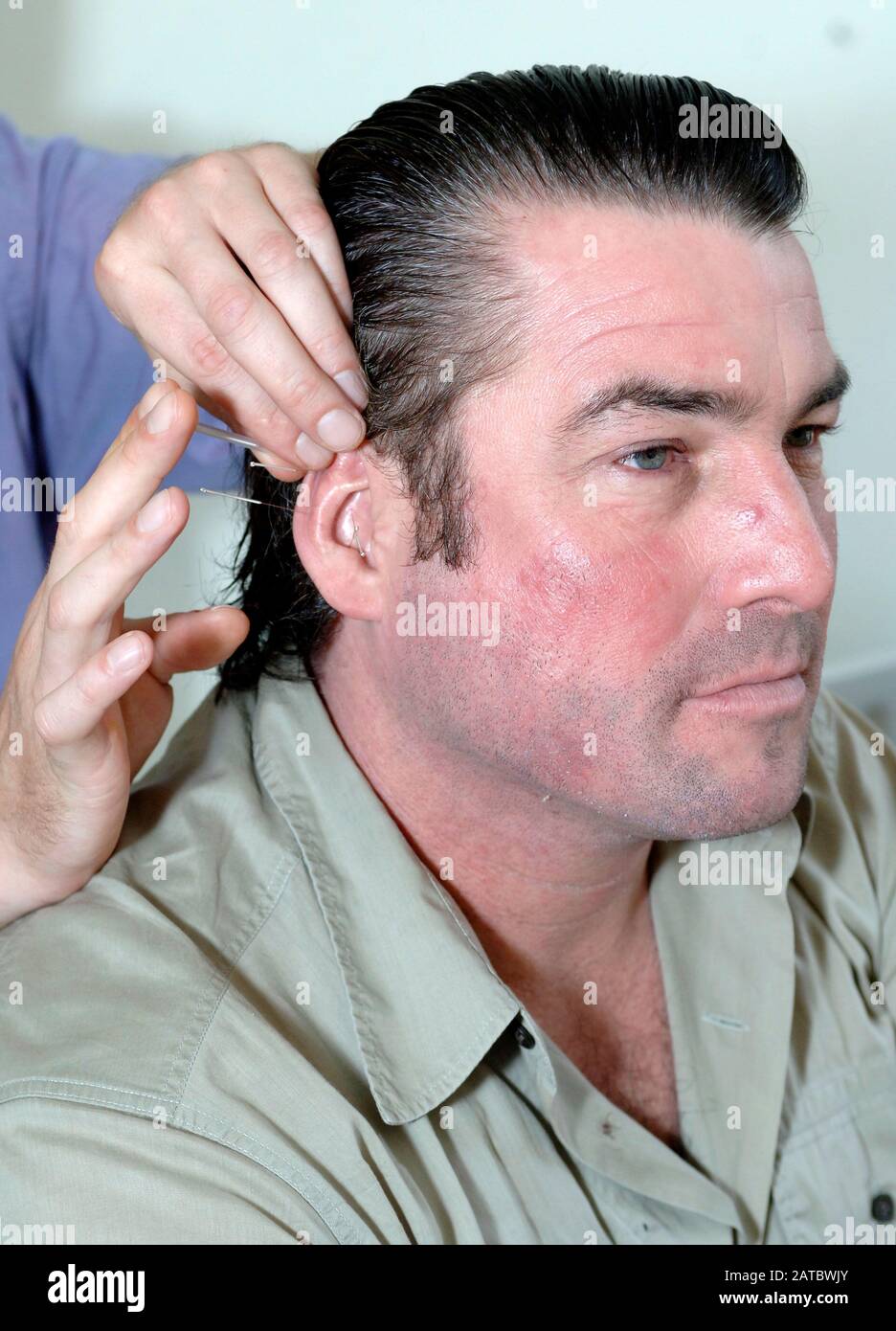 TV chef Ross Burden undergoing an acupuncture procedure at the Hale ...