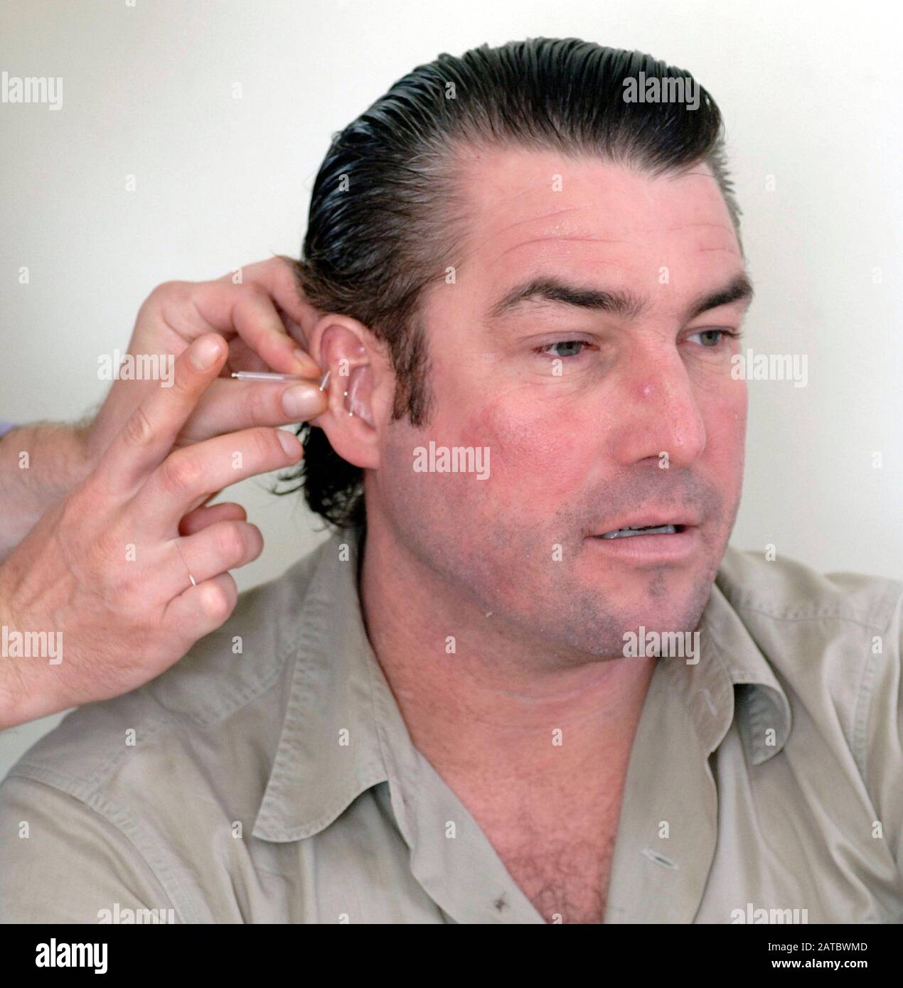 TV chef Ross Burden undergoing an acupuncture procedure at the Hale ...