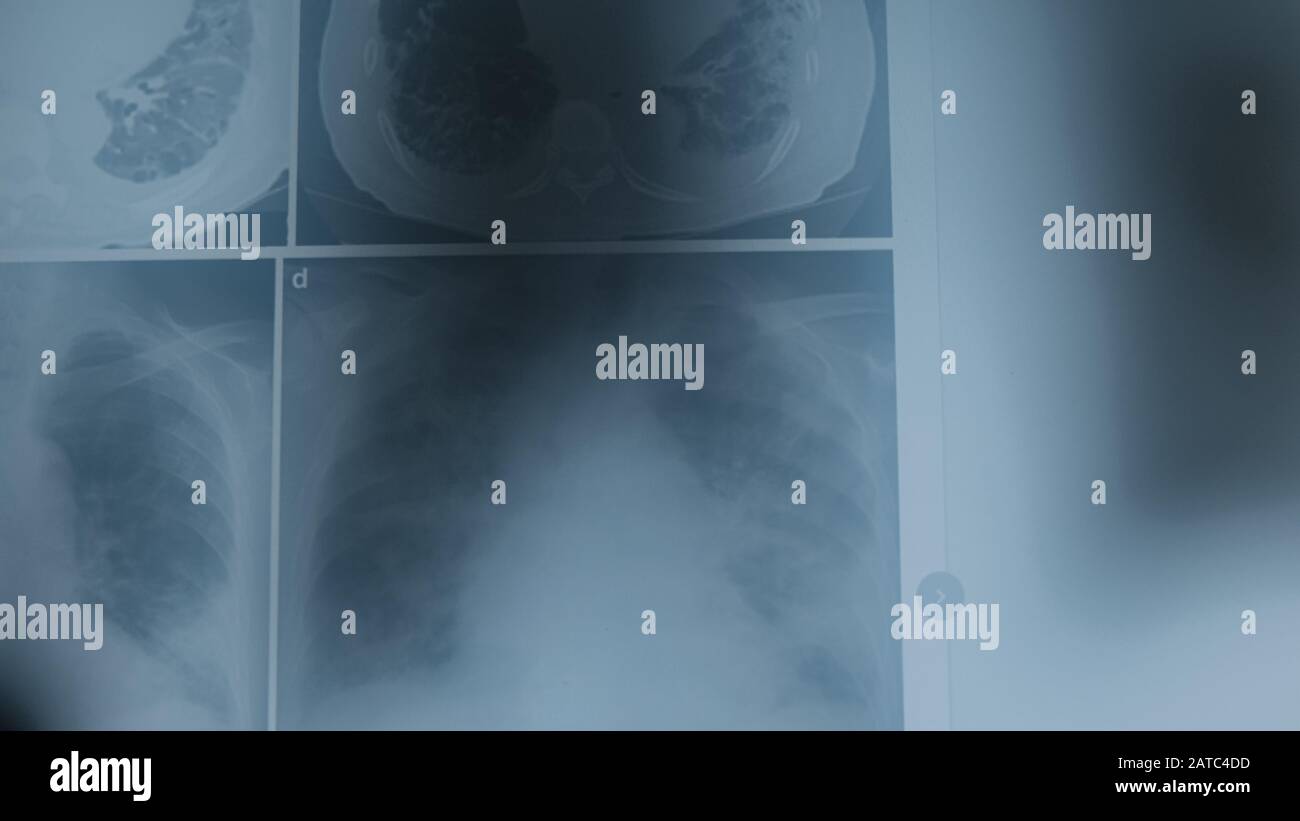 Doctor examining at lungs radiograph x-ray film of patient in operation ...