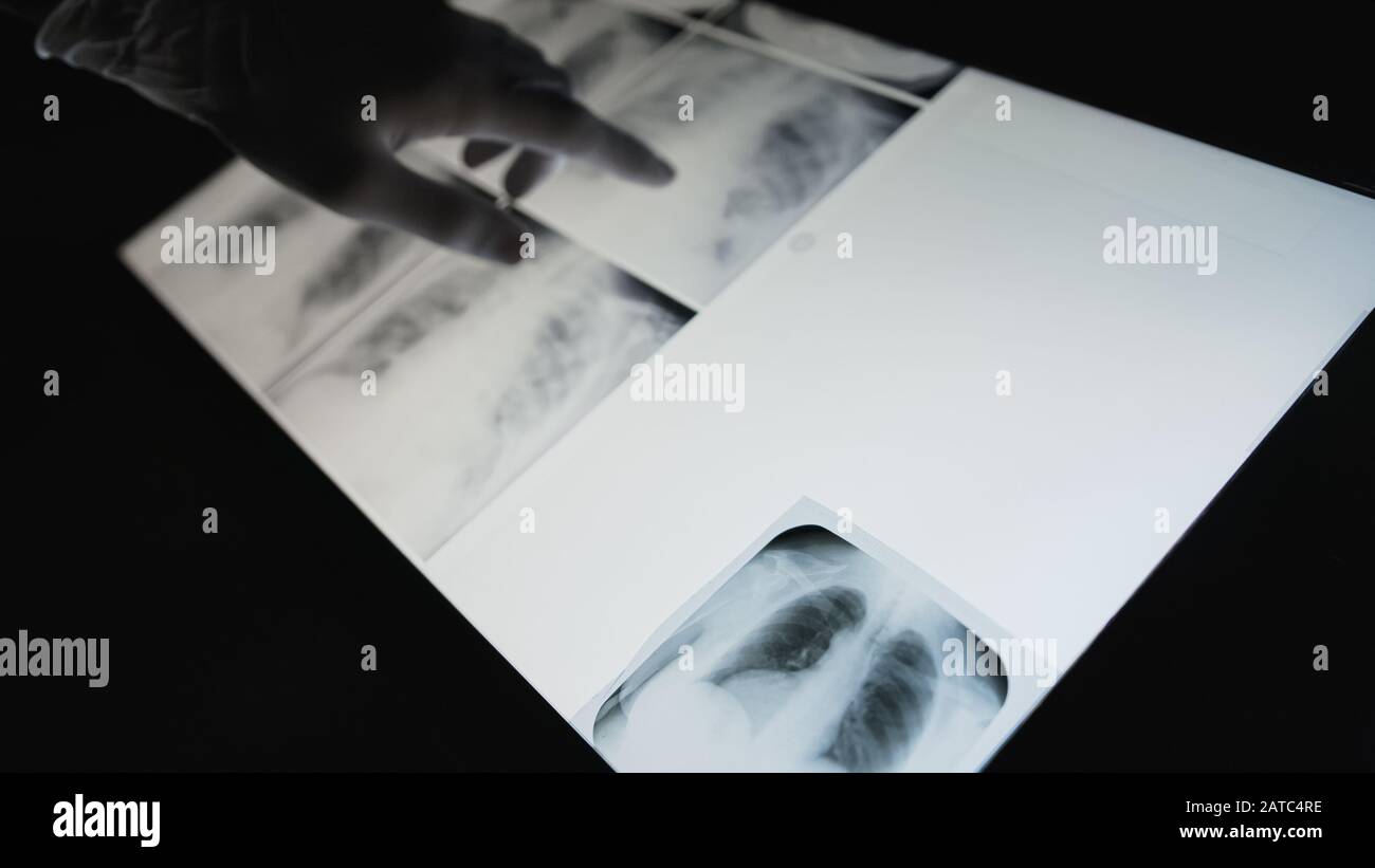 Doctor checking on chest X-ray. Man holding radiography looking at it ...