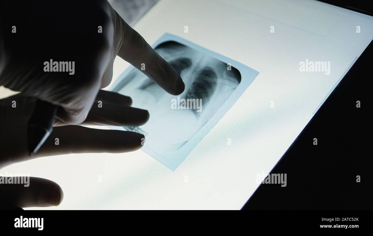 Doctor checking on chest X-ray. Man holding radiography looking at it ...