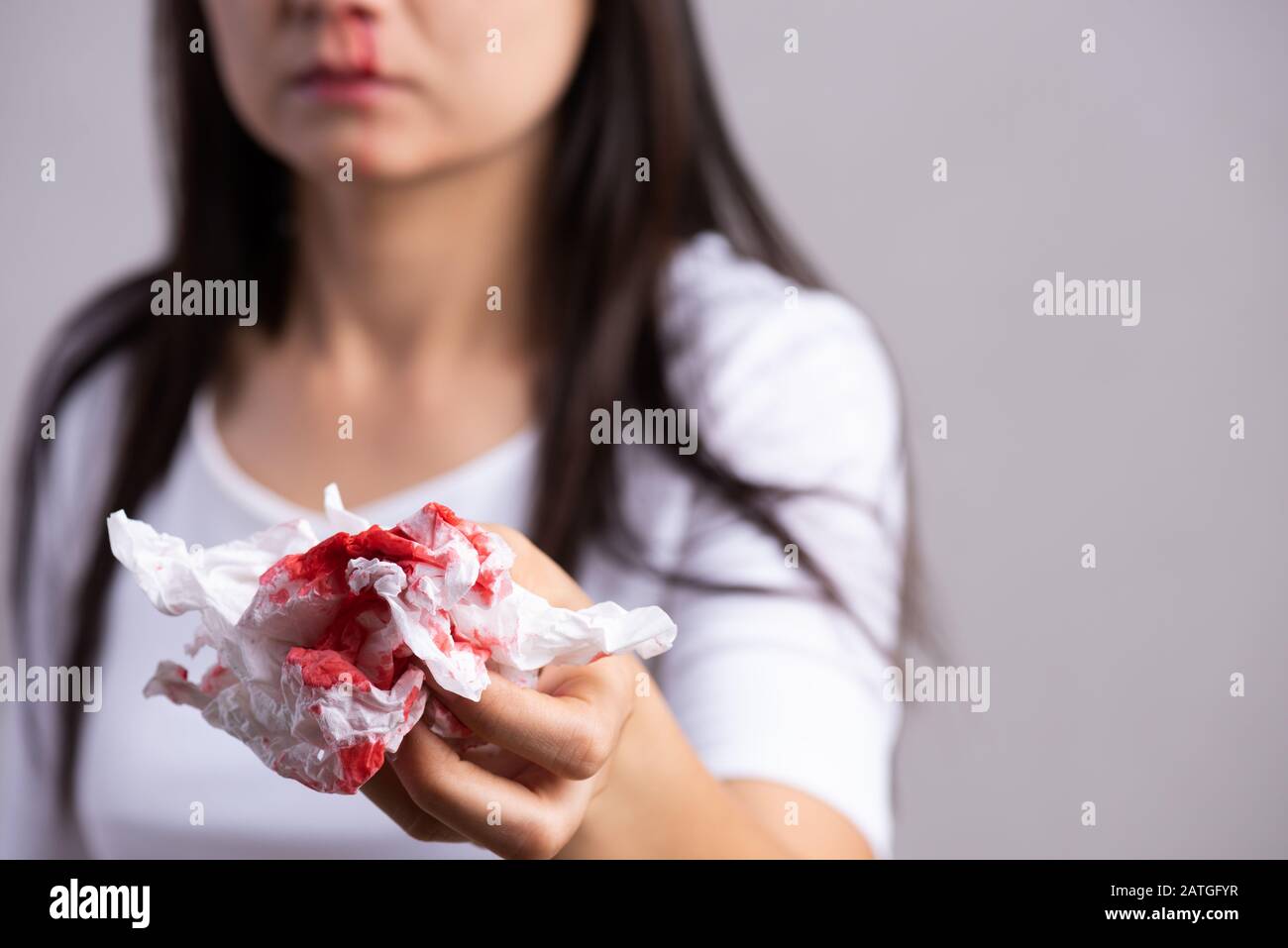 Nosebleed , a young woman suffering from nose bleeding and using tissue ...