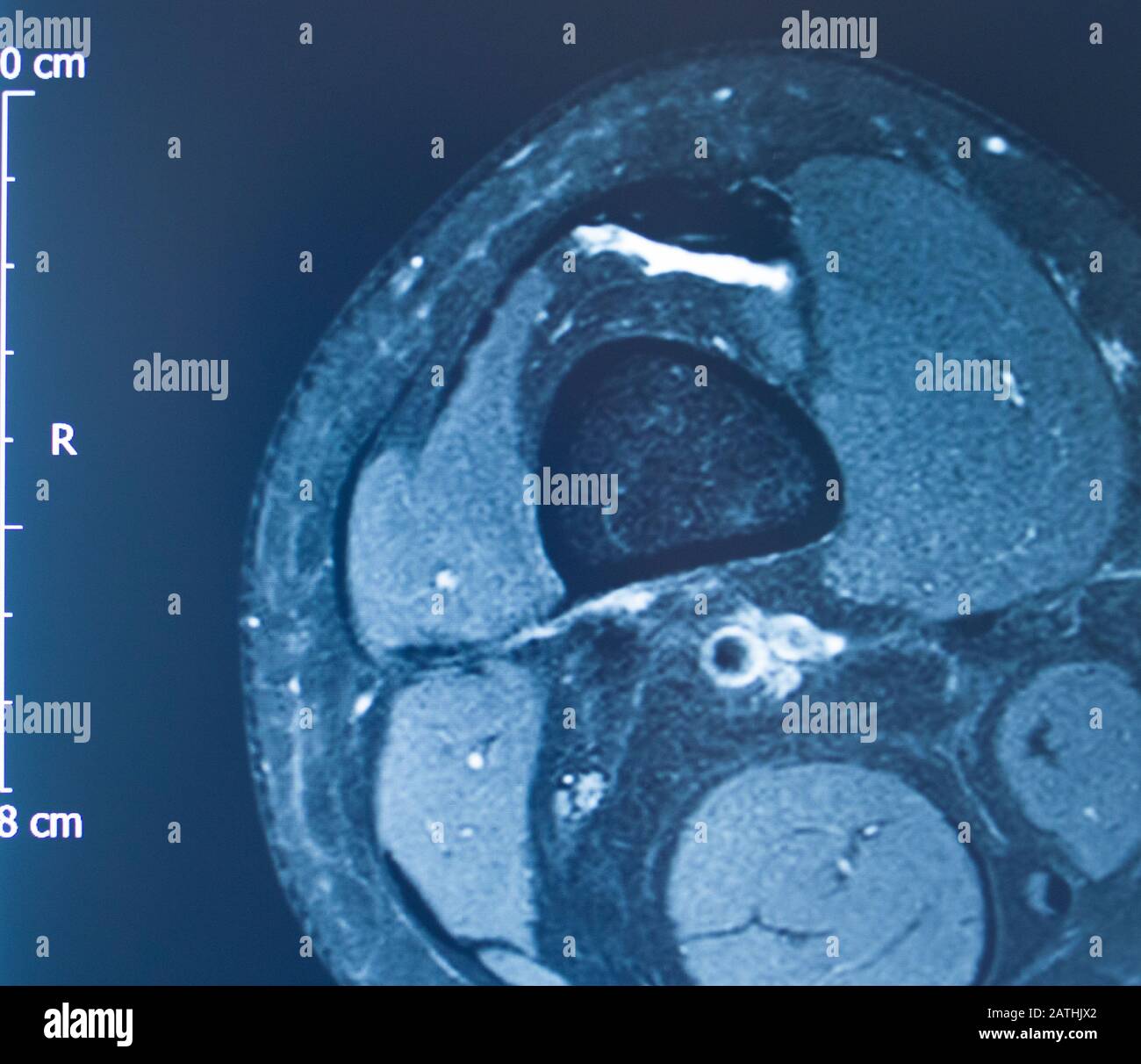 Knee sports injury mri mcl grade 2 tear magnetic resonance imaging ...