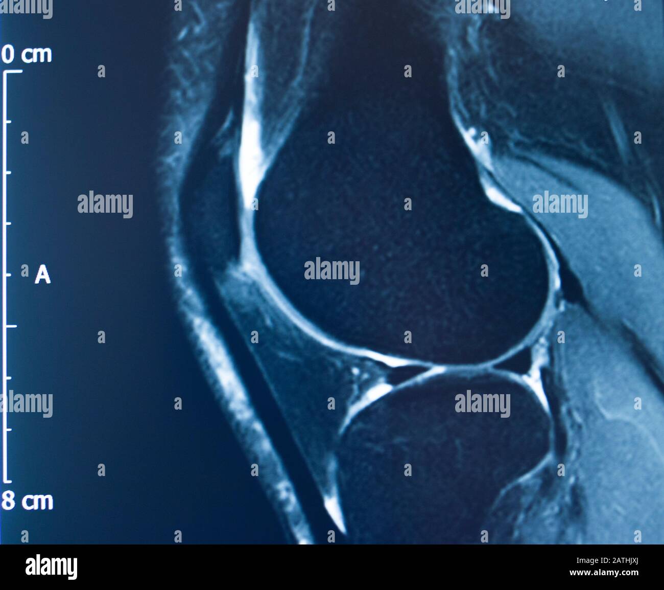 Knee sports injury mri mcl grade 2 tear magnetic resonance imaging ...