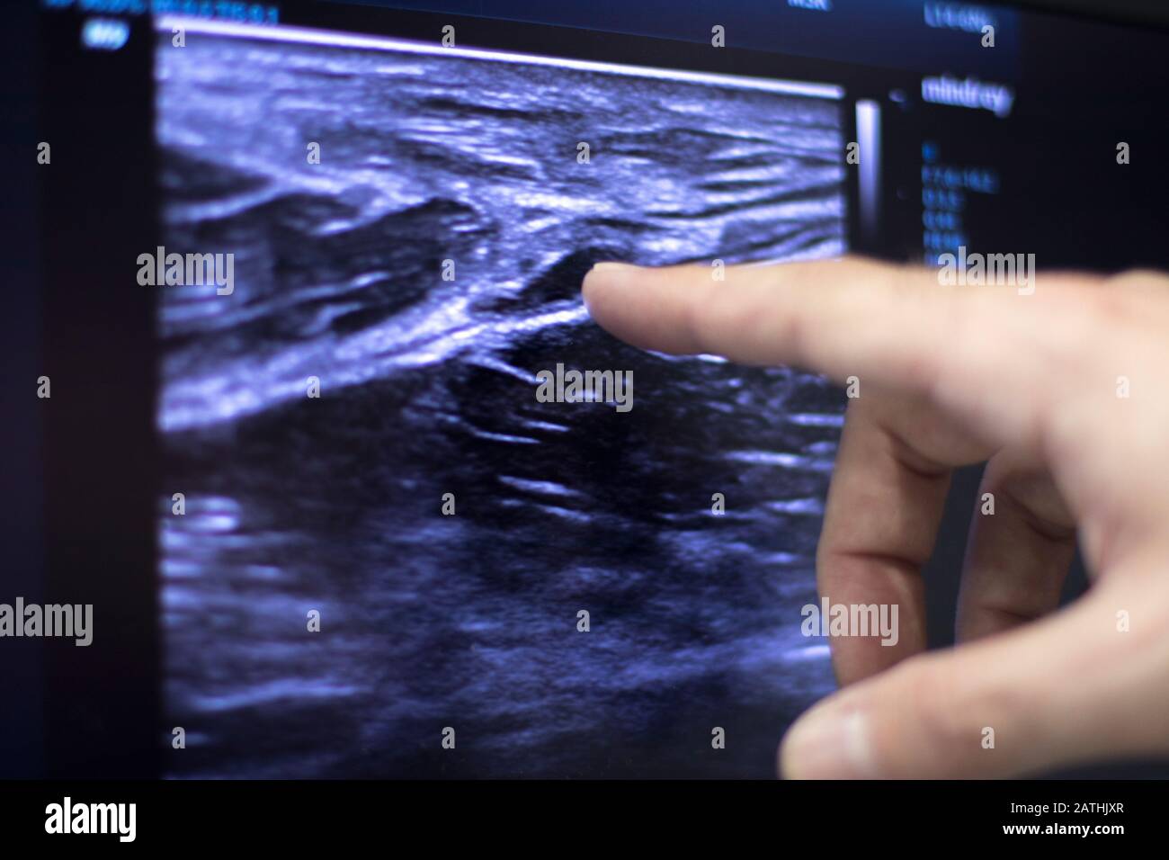 EPI Intratissue Percutaneous Electrolysis dry needling ultrasound ecography scan physiotherapy ...