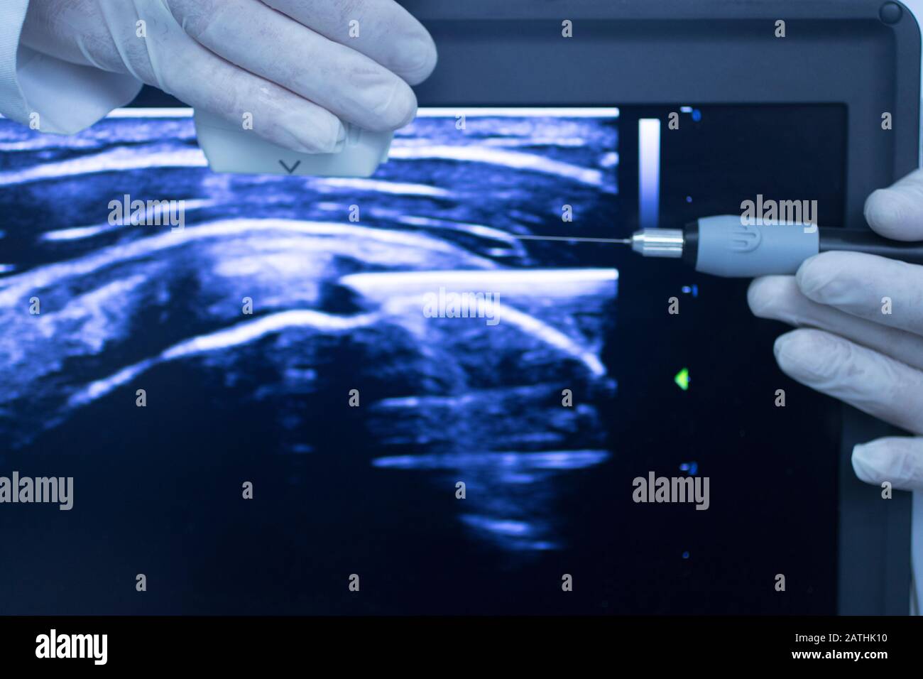 EPI Intratissue Percutaneous Electrolysis dry needling ultrasound ecography scan physiotherapy ...