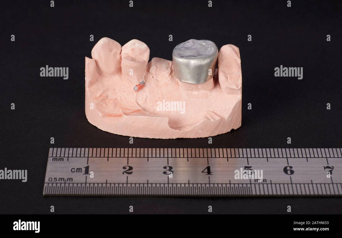 Plaster cast section of upper left teeth from middle-aged human male ...