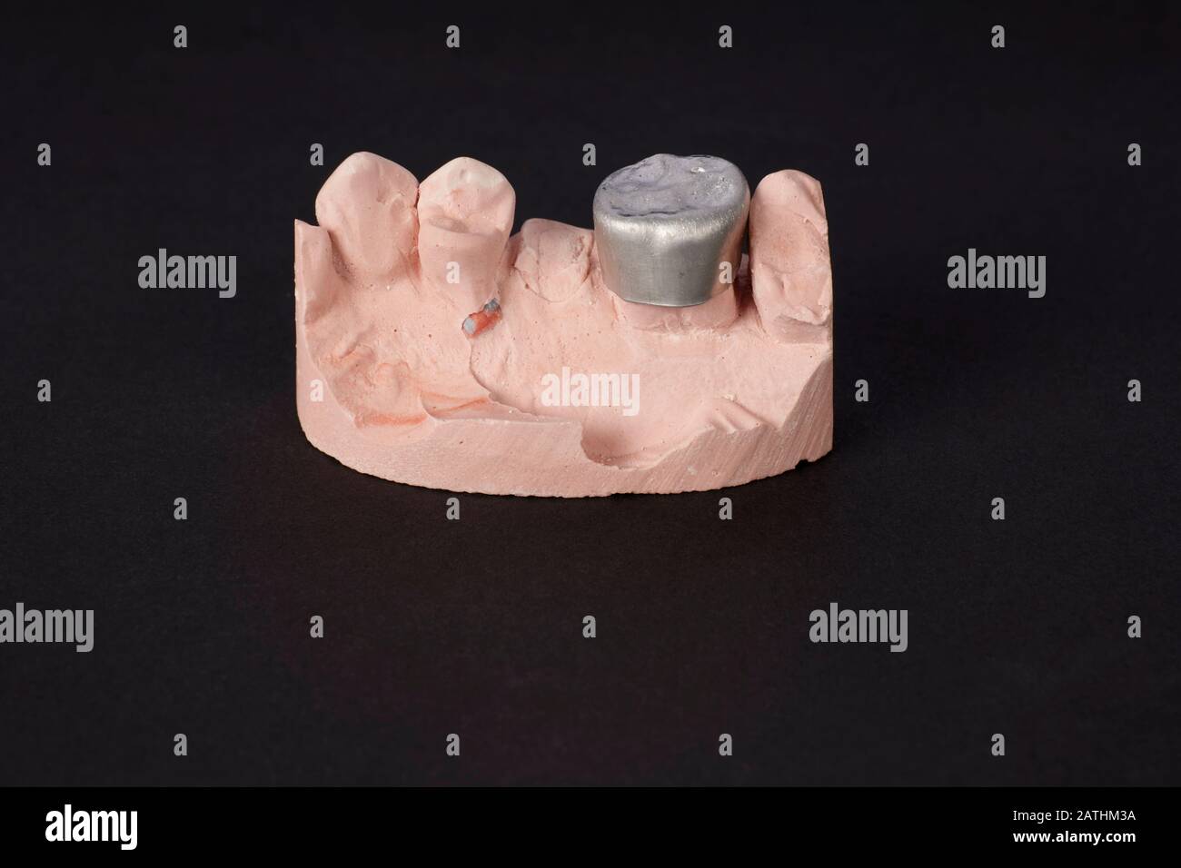Plaster cast section of upper left teeth from middle-aged human male ...