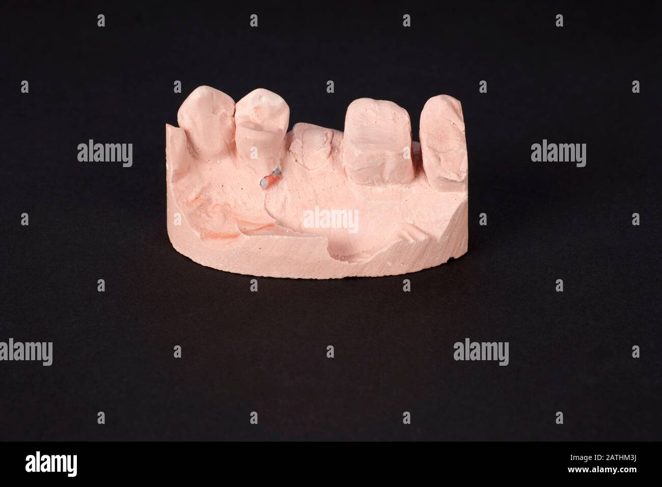 Plaster cast section of upper left teeth from middle-aged human male ...