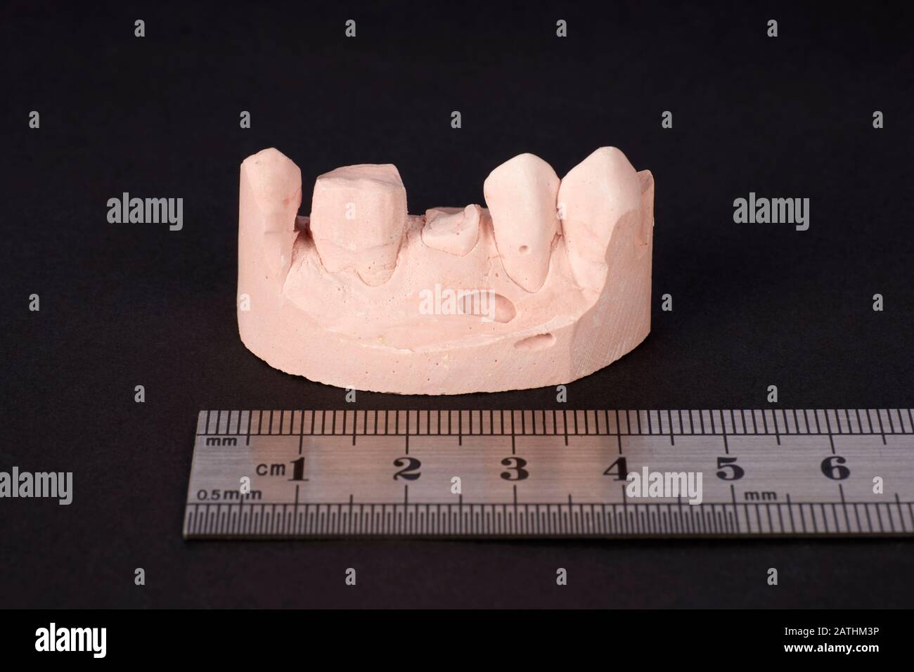 Plaster cast section of upper left teeth from middle-aged human male ...