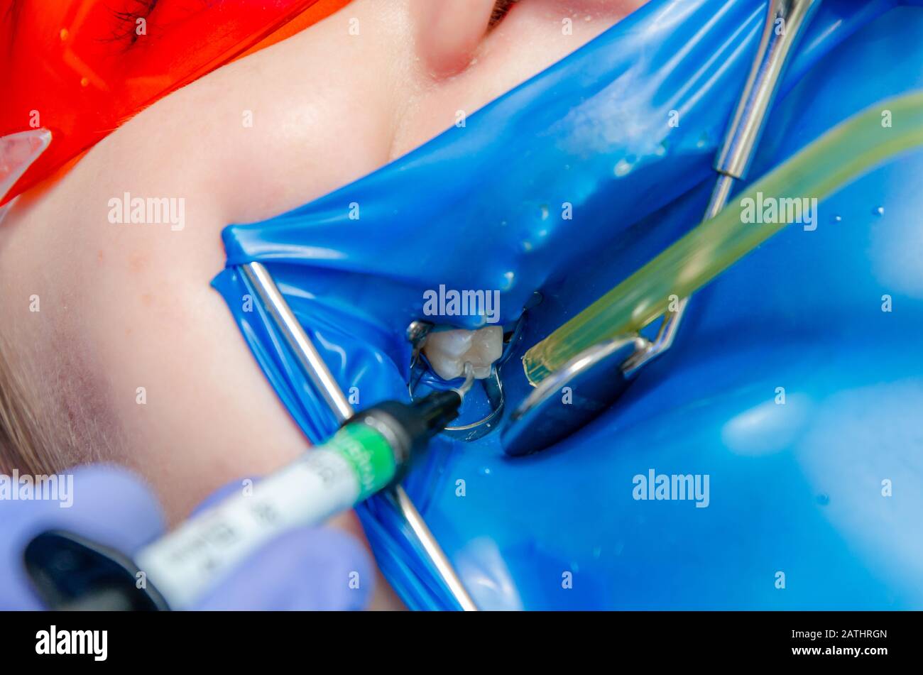 Tooth treatment in dentistry. The mouth is covered with a blue rubber ...