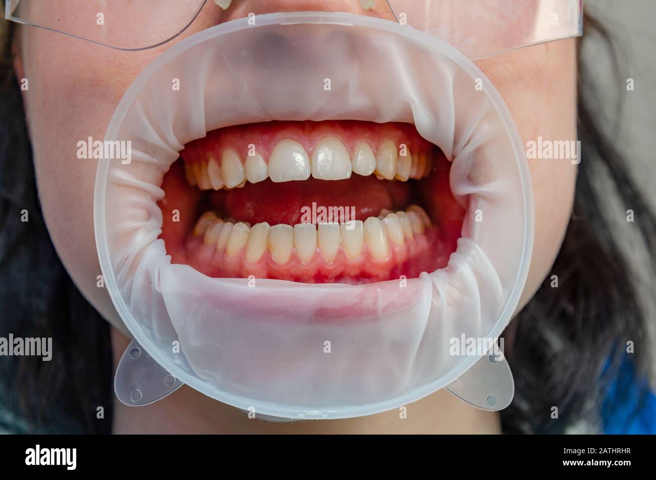 Teeth in the mouth at the dental clinic, the mouth is opened with a ...