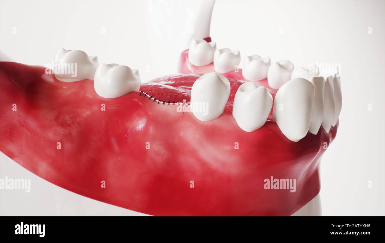 Tooth implantation picture series 8 of 13 - 3D Rendering Stock Photo ...