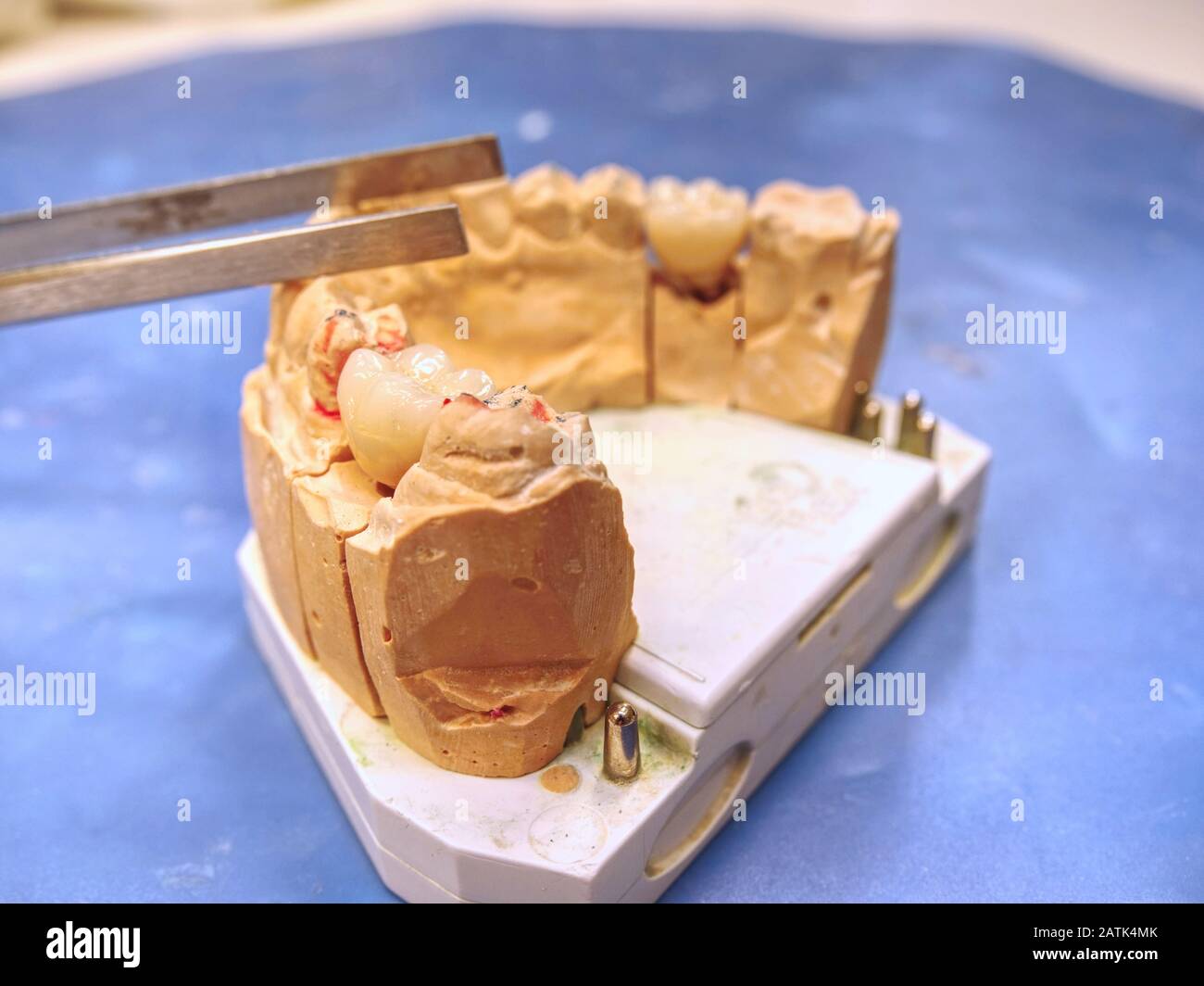 Plaster cast of human jaws. Dental casting gypsum model jaws in ...