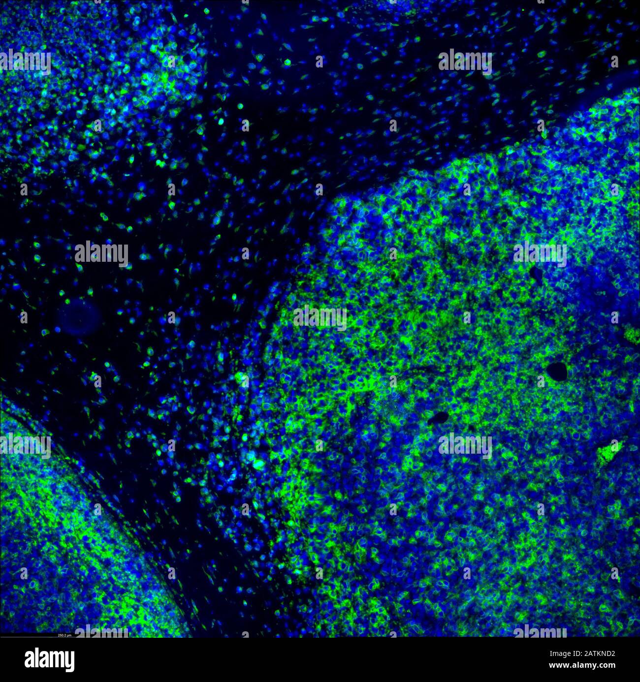 Tumour immunofluorescence IHC image of immunotherapy treatment. Tumor ...