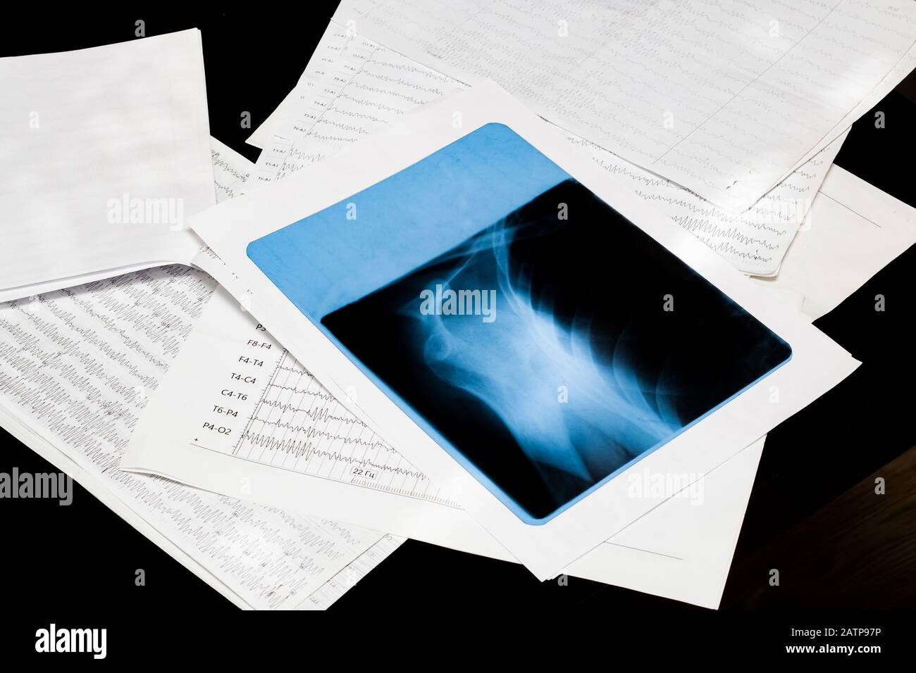 X-rays of the shoulder on white papers Stock Photo - Alamy