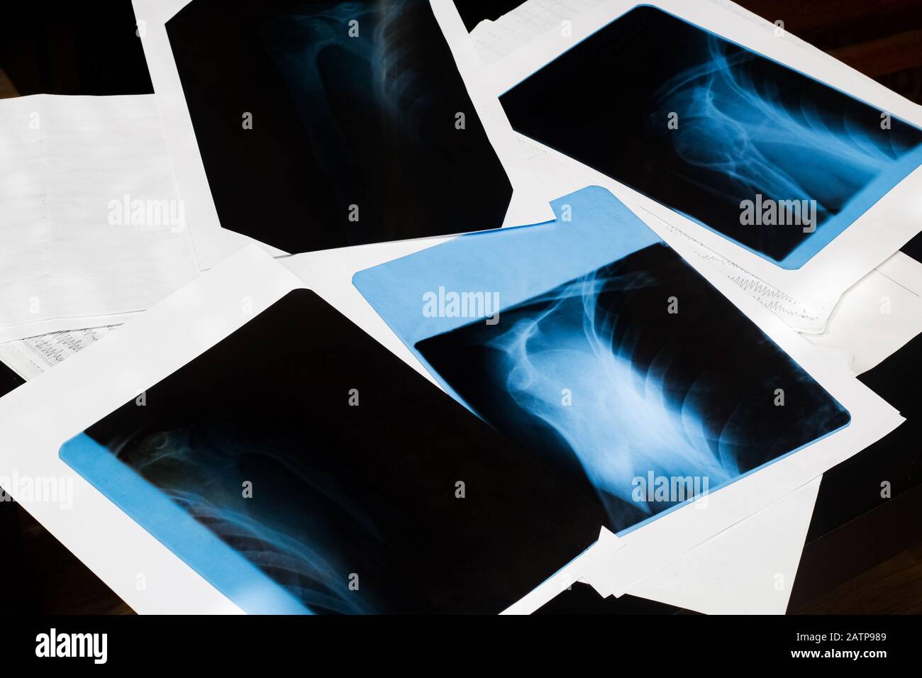X-rays of the shoulder on white papers Stock Photo - Alamy