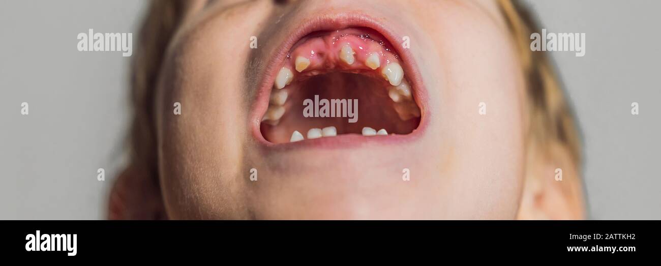 Abnormal boy tooth. The extra narrow strange tooth grew in the boy's ...